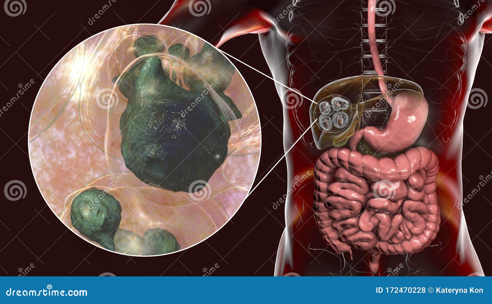 Hydatid Cyst of Echinococcus Multilocularis Stock Illustration ...