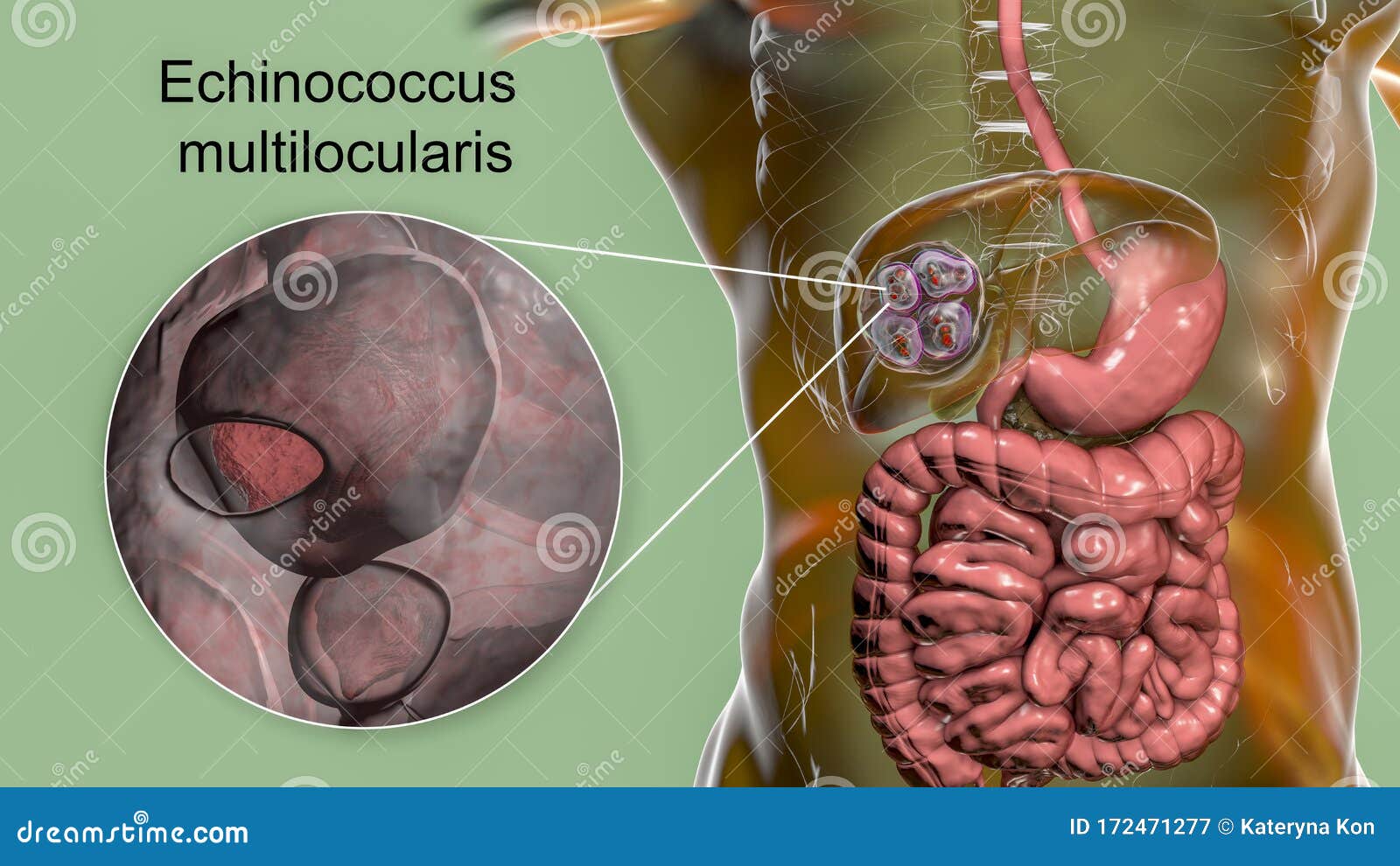 Hydatid Cyst of Echinococcus Multilocularis Stock Illustration ...