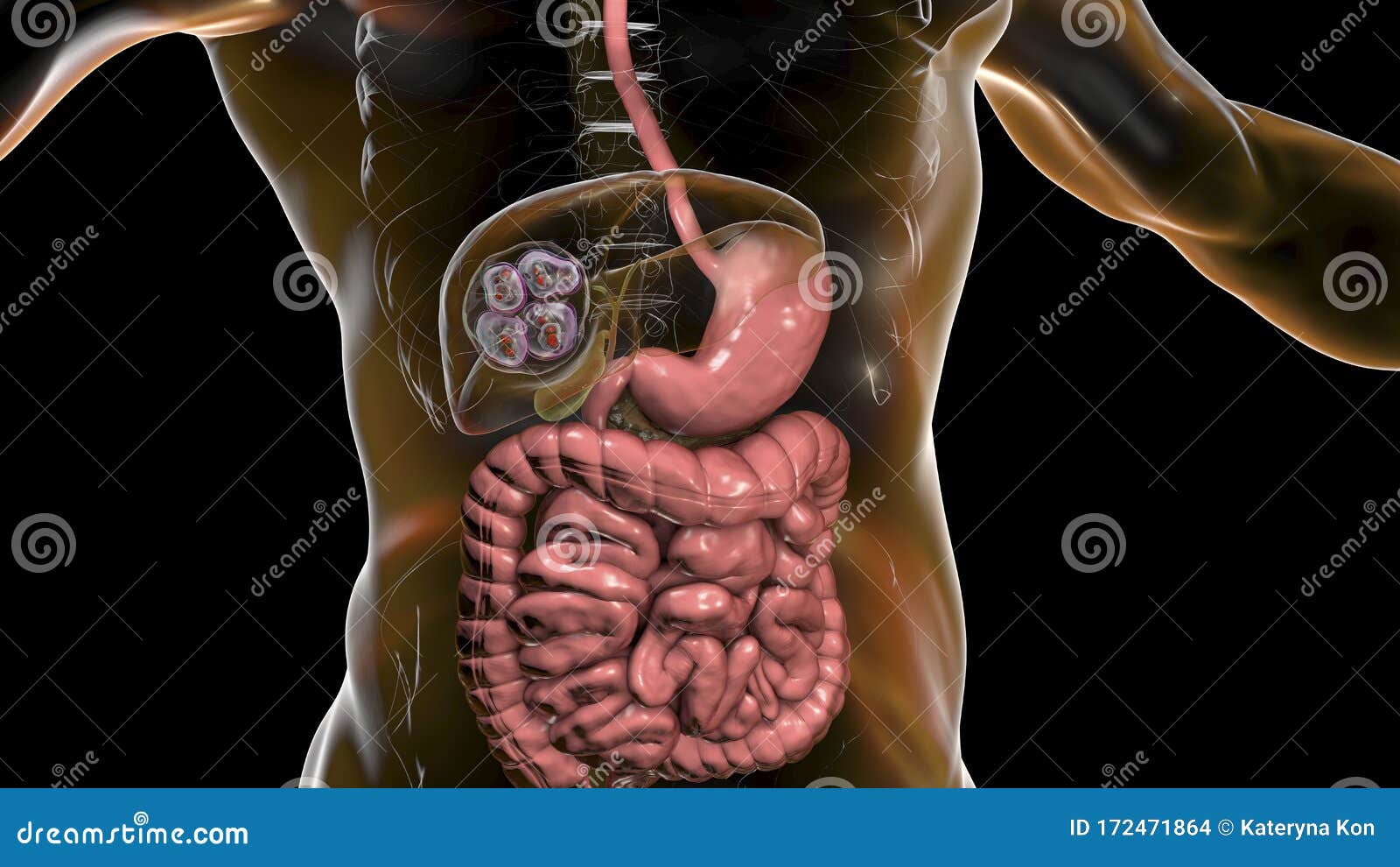 Hydatid Cyst of Echinococcus Multilocularis Stock Illustration ...