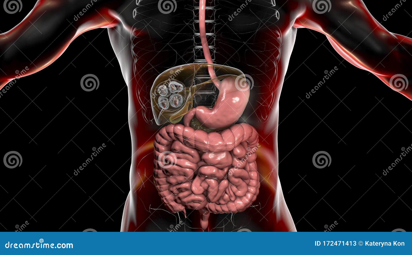 Hydatid Cyst of Echinococcus Multilocularis Stock Illustration ...