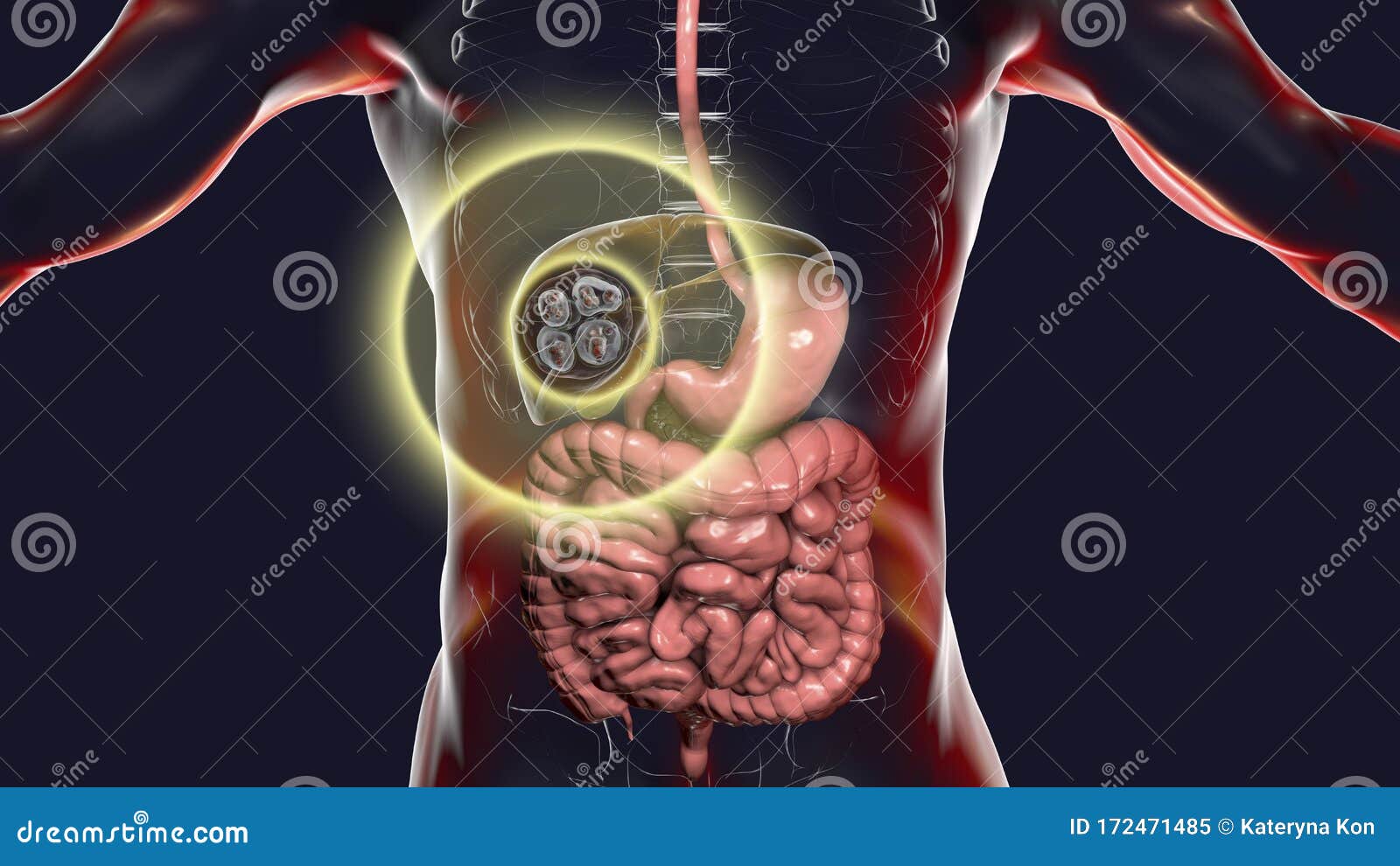 Hydatid Cyst of Echinococcus Multilocularis Stock Illustration ...