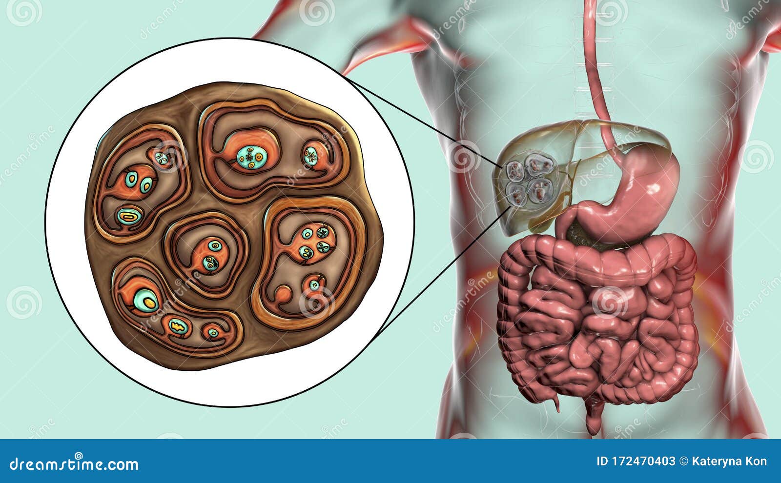 Hydatid Cyst Of Echinococcus Multilocularis Stock Illustration Illustration Of Pathology Cyst