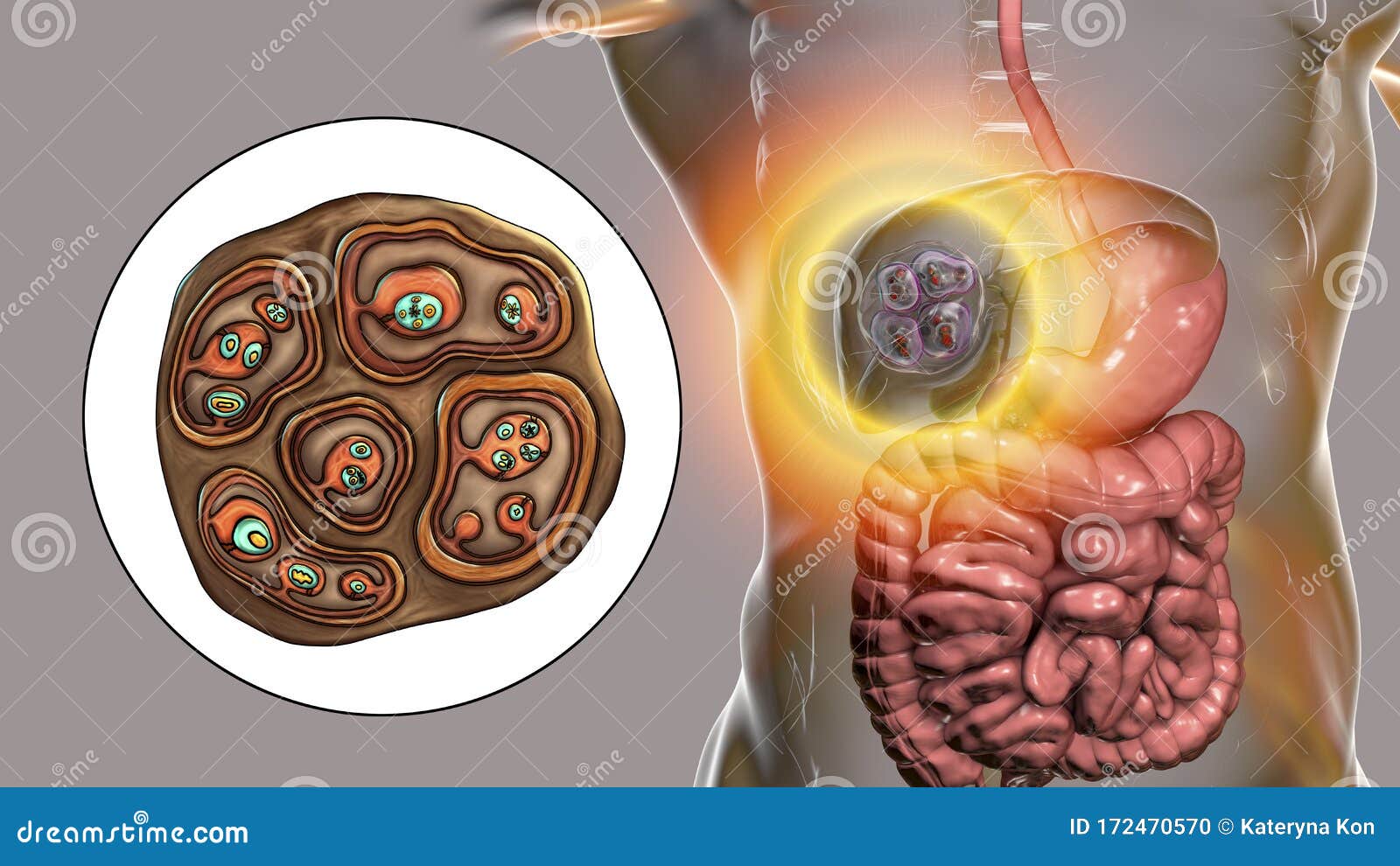 Hydatid Cyst Of Echinococcus Multilocularis Stock Illustration