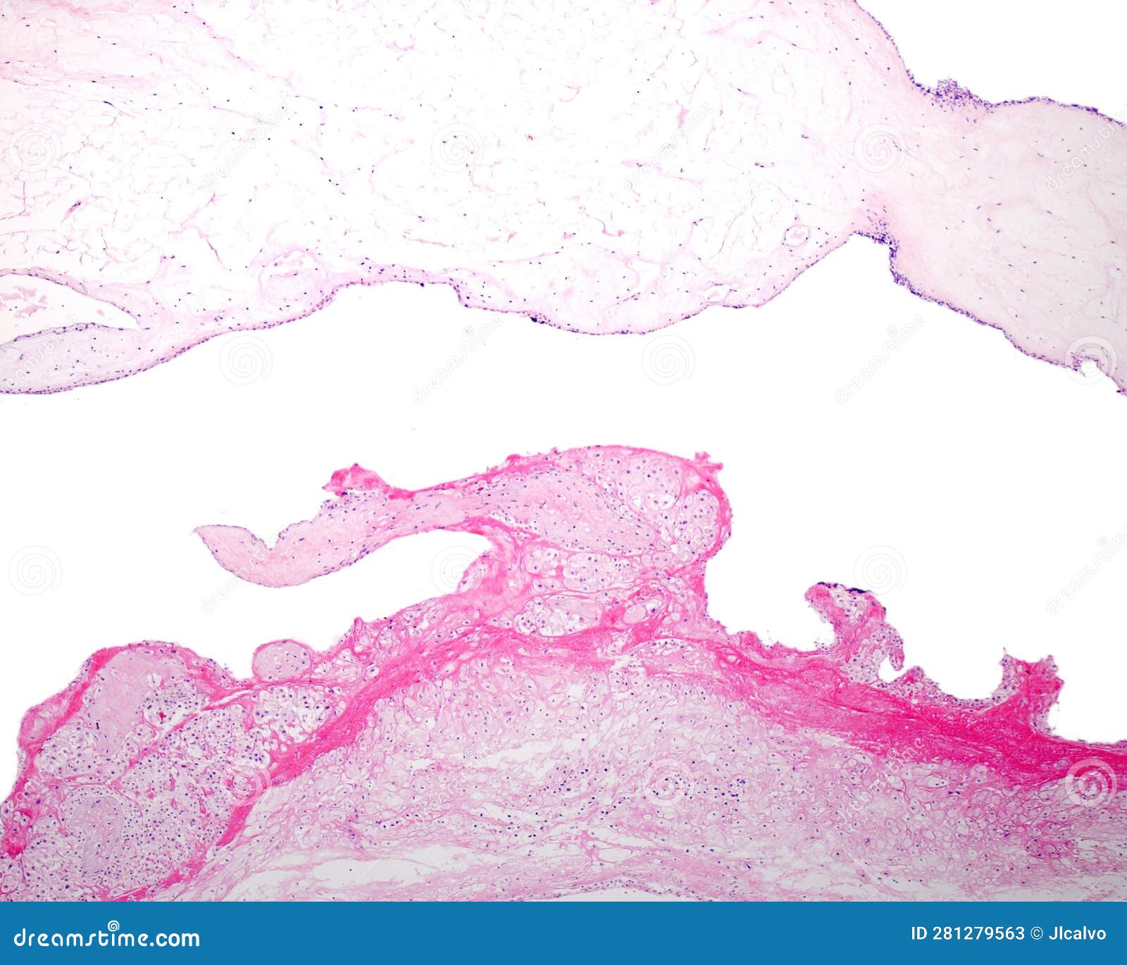 Hydatidiform mole stock illustration. Illustration of histology - 281279563