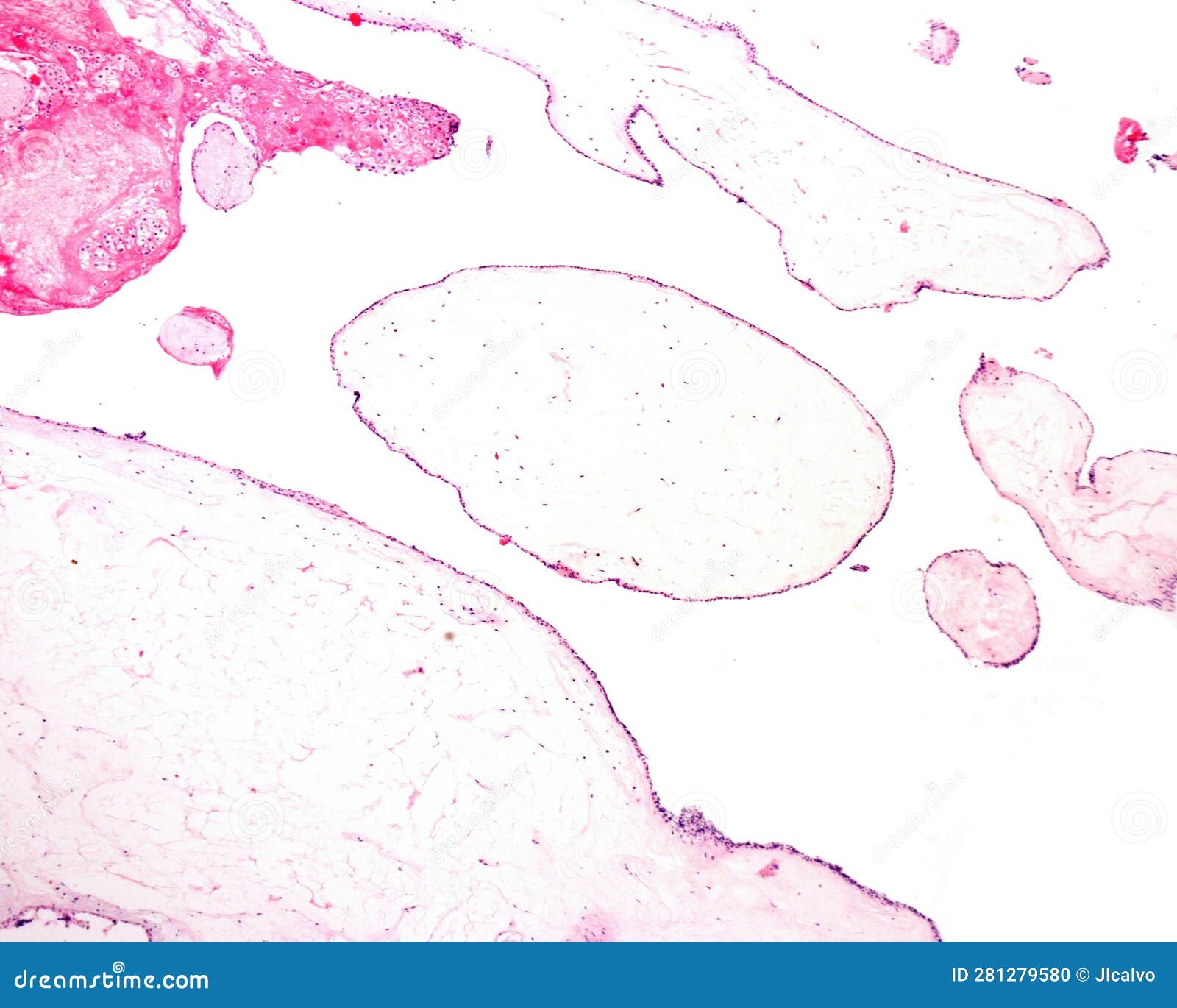 Hydatidiform mole stock photo. Image of gynaecological - 281279580