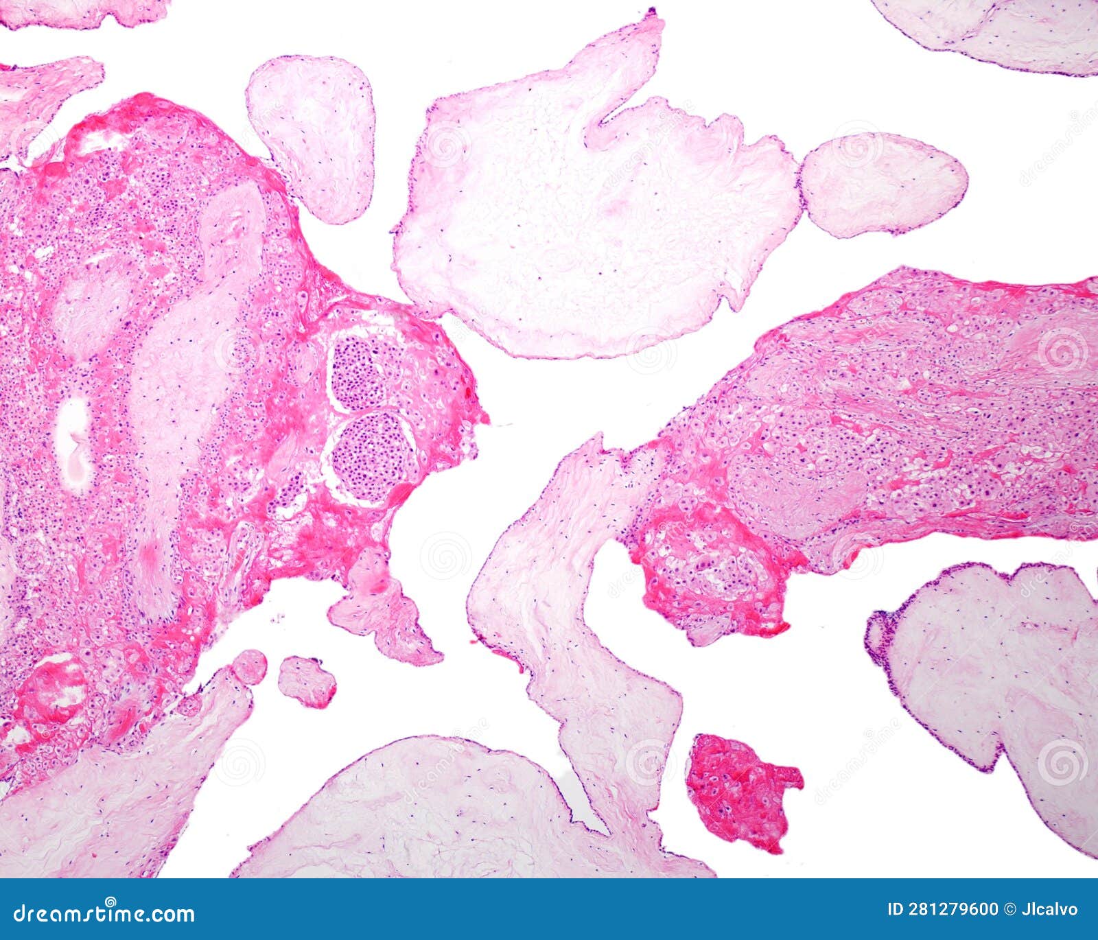 Hydatidiform mole stock photo. Image of histological - 281279600