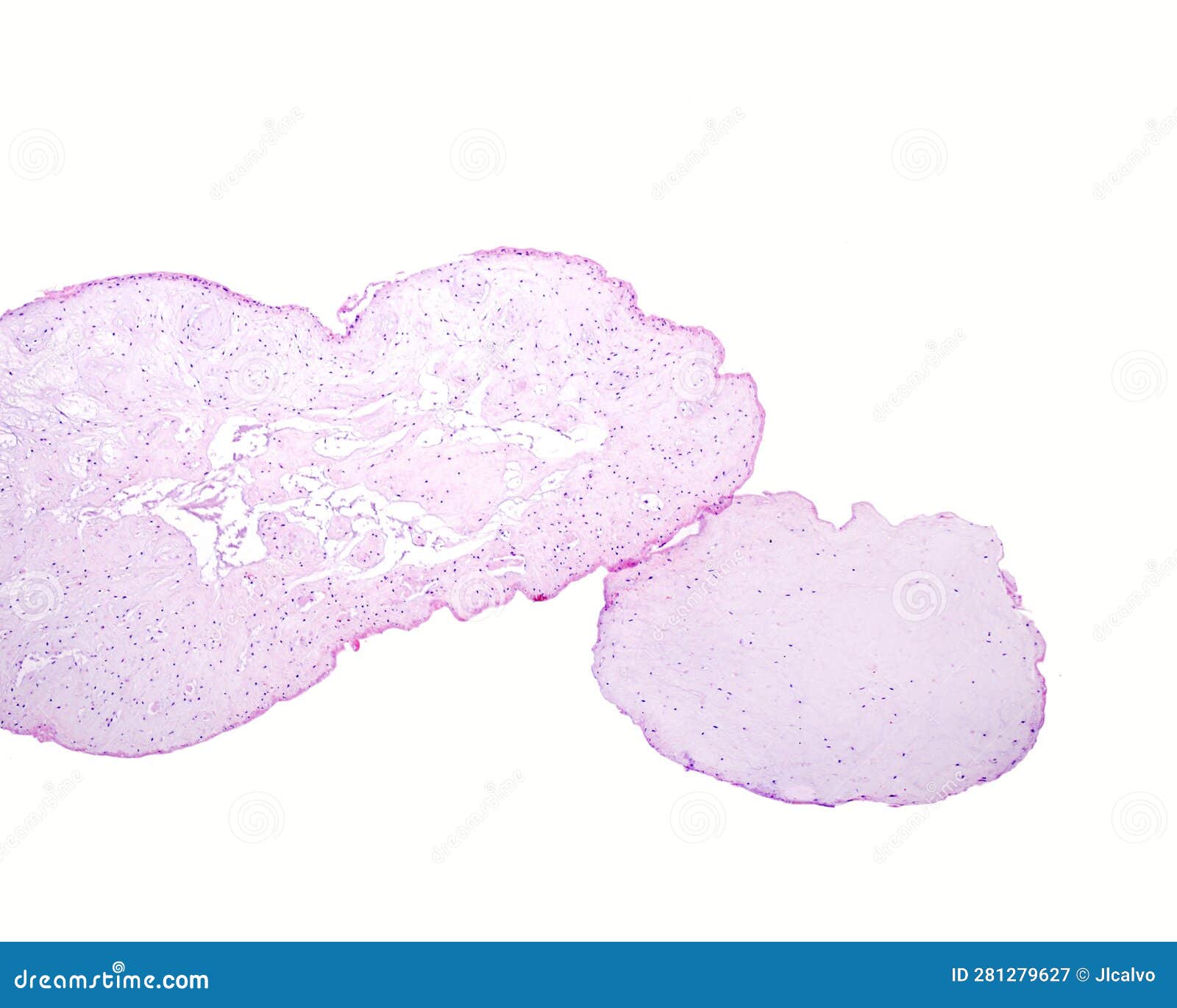 Hydatidiform mole stock image. Image of microscopy, micrograph - 281279627
