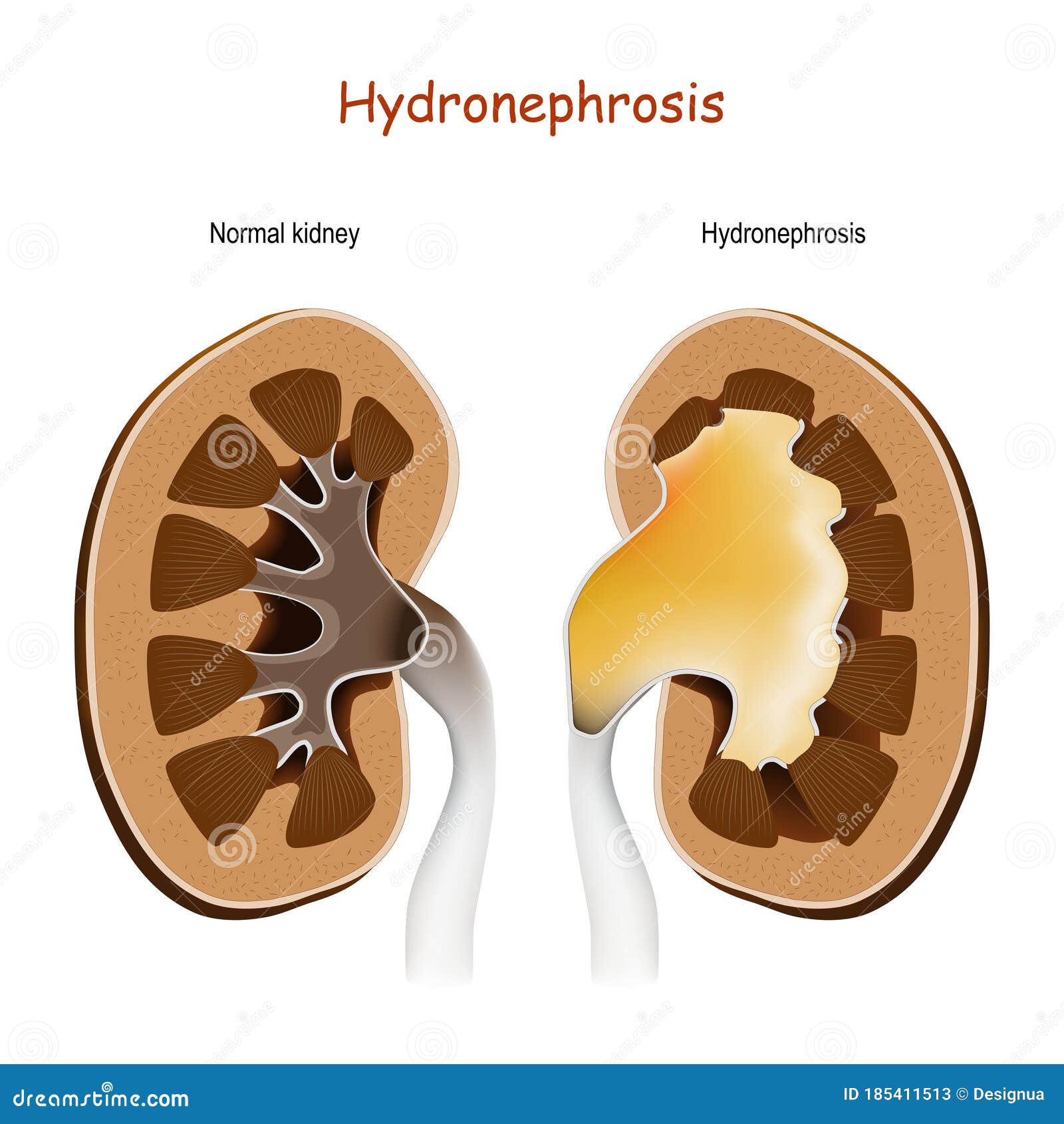 Hydronephrosis. Normal Kidney and Kidney with Disorders Stock Vector ...