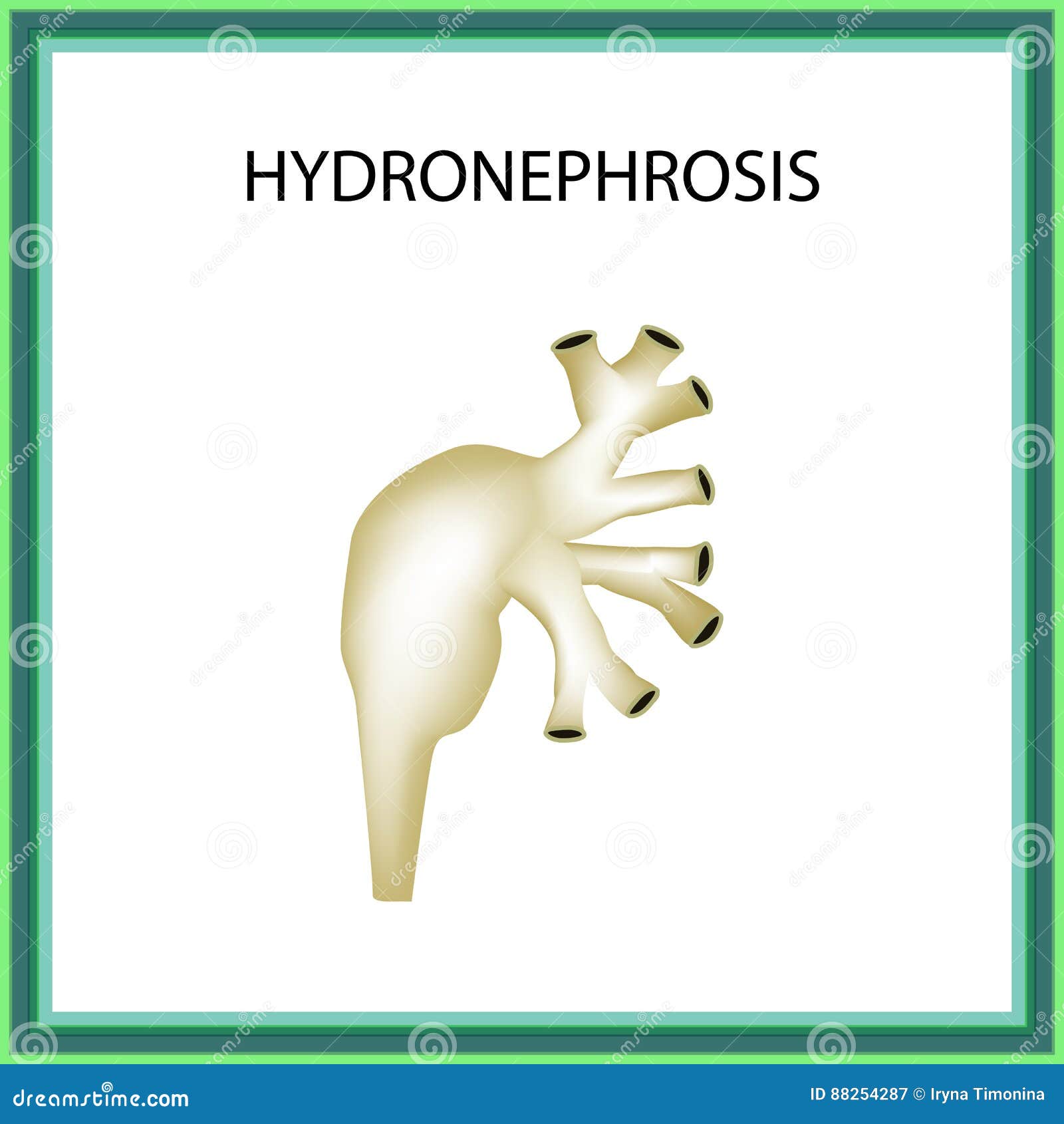 Renal Hydronephrosis Is A Progressive,stages Of The Disease Cartoon ...