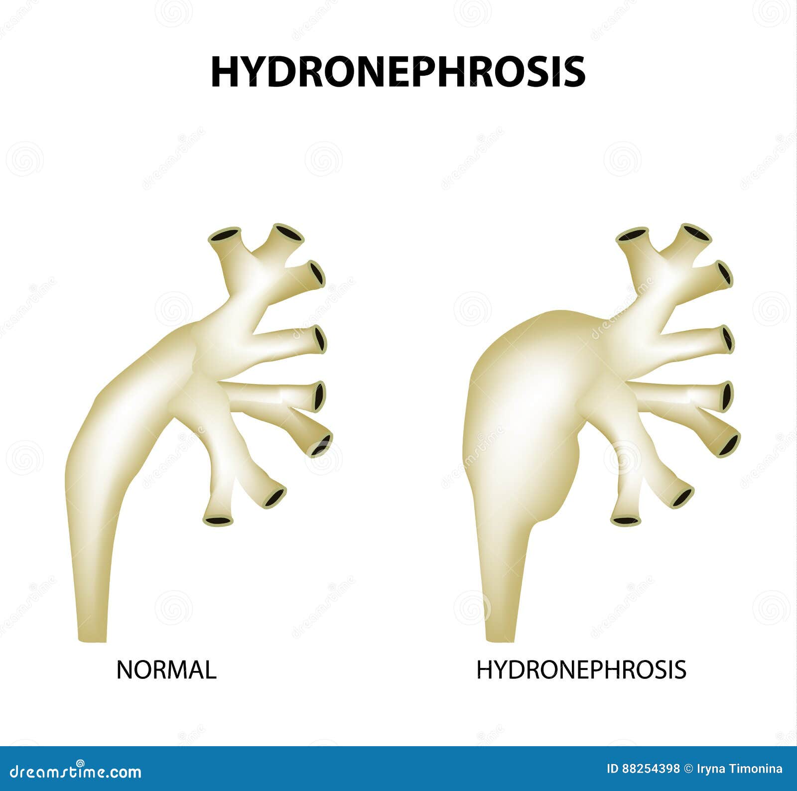 Renal Hydronephrosis Is A Progressive,stages Of The Disease Cartoon ...