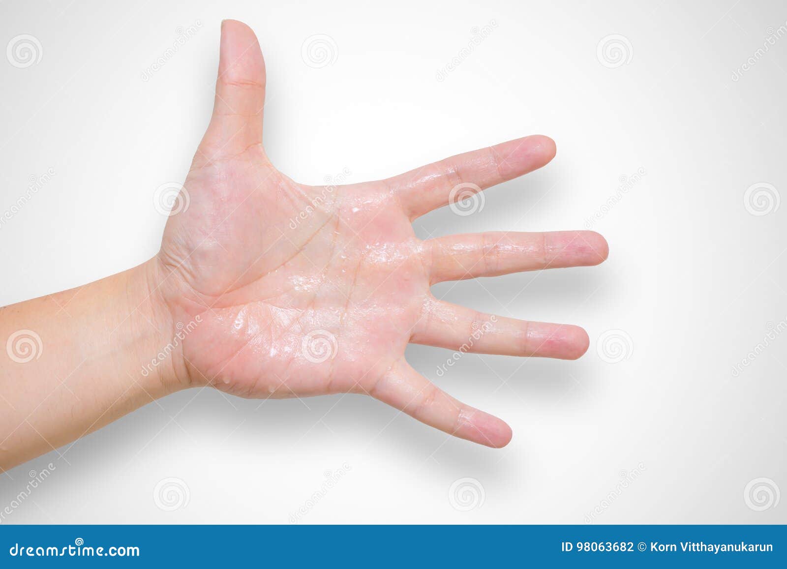 Hyperhidrosis Wet Hand Sweat Syndrome Stock Photos - Free & Royalty ...