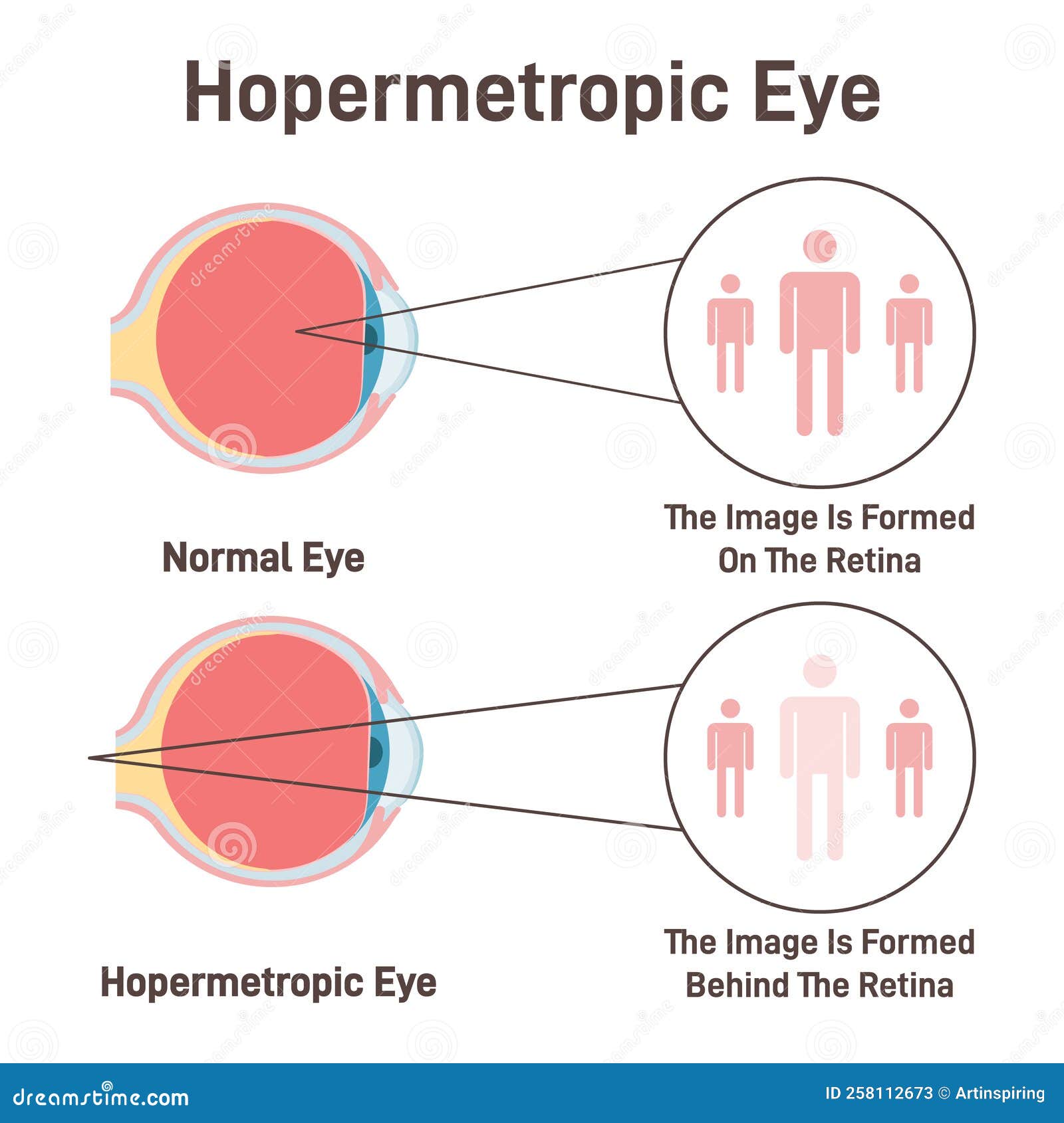 Hypermetropic Astigmatism. Hyperopic Eye Vision with Comparison Stock ...