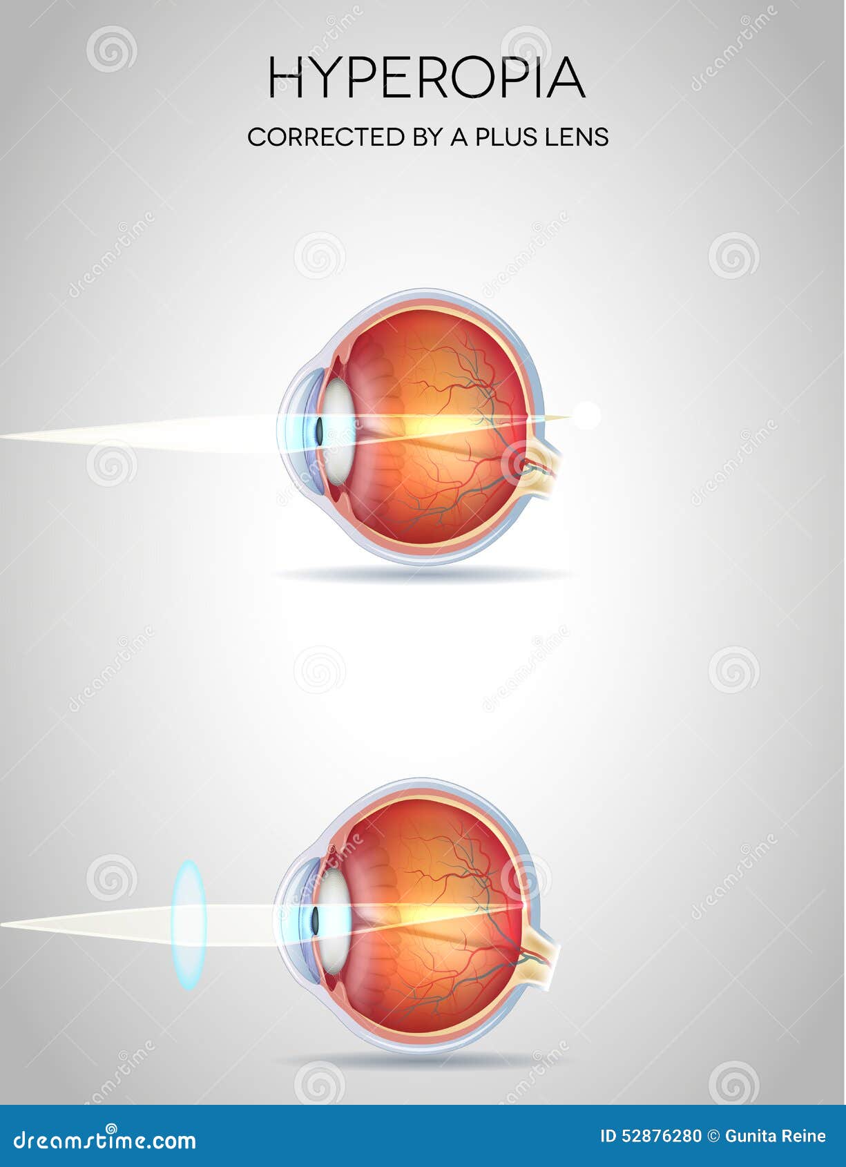 Hyperopia ilustração do vetor. Ilustração de medicina - 52876280