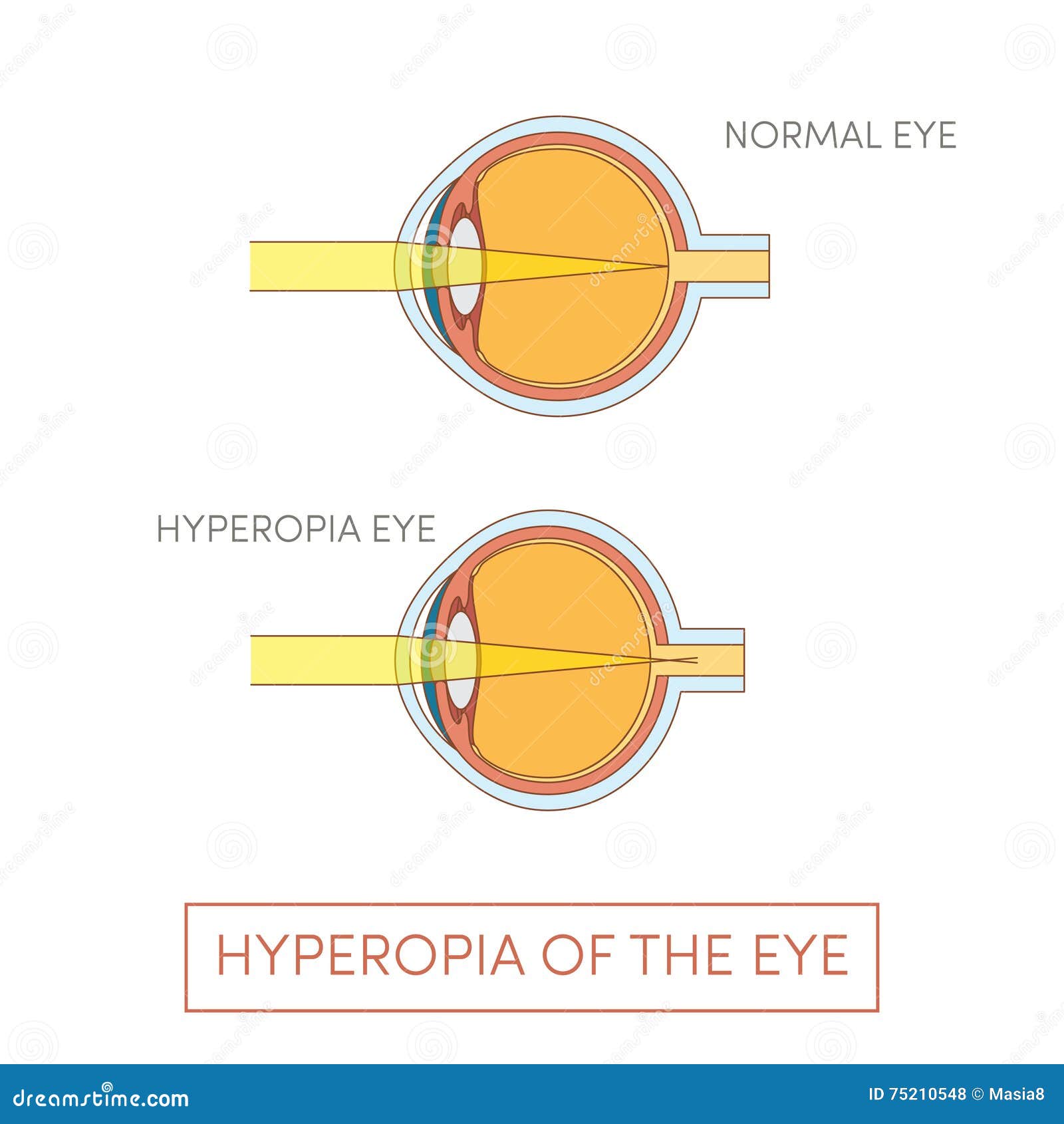 Hyperopia of the eye stock illustration. Illustration of farsightedness ...