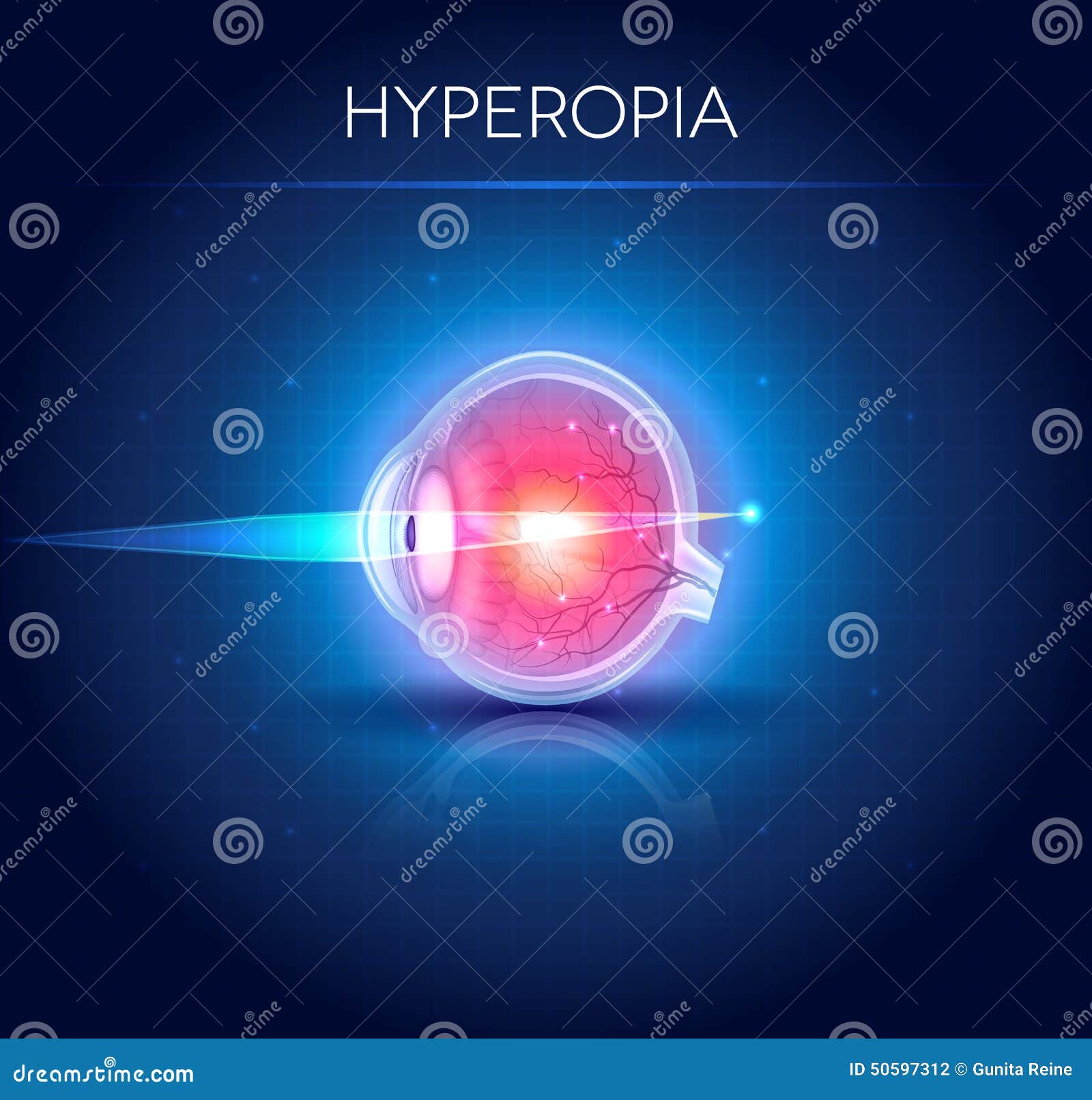 Hyperopia Eyesight Disorder Stock Vector - Illustration of eyeball ...