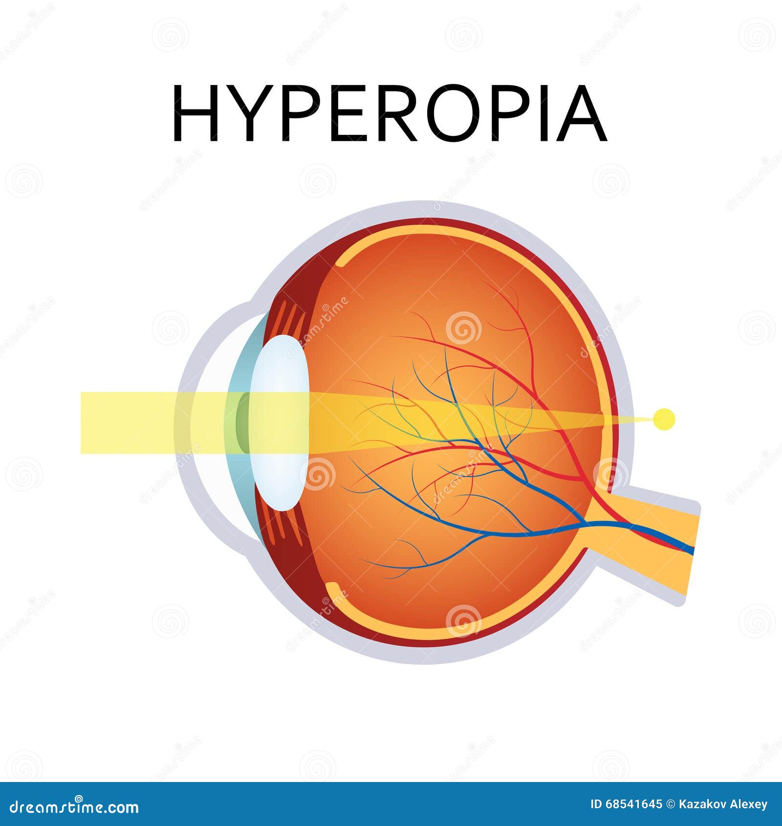 Hyperopia Eyesight Disorder. Stock Vector - Illustration of optic ...