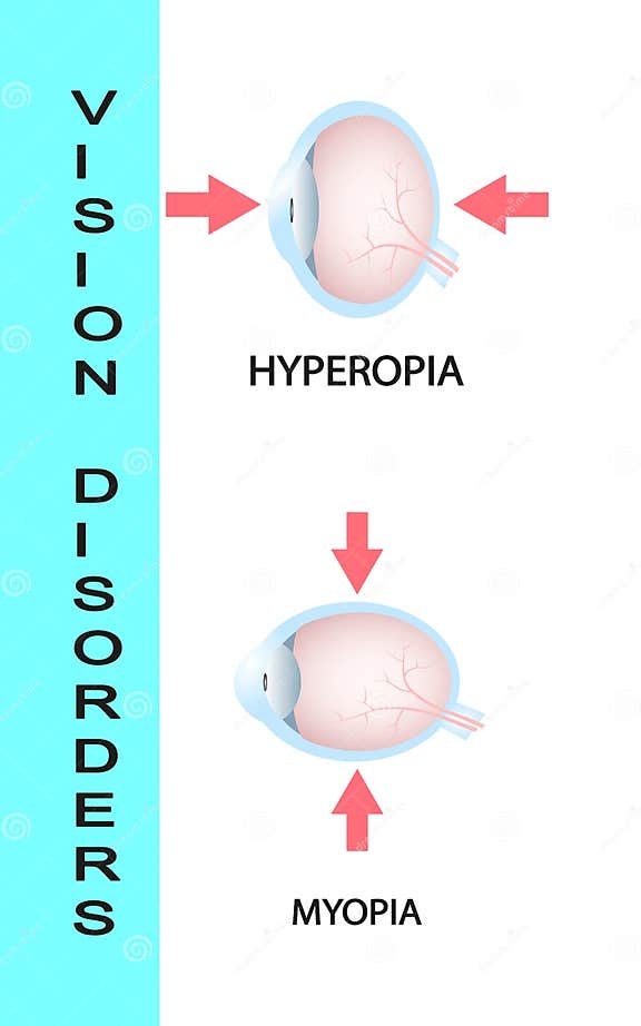 Hyperopia and Hyperopia Corrected by a Plus Lens. Eye Vision Disorder ...