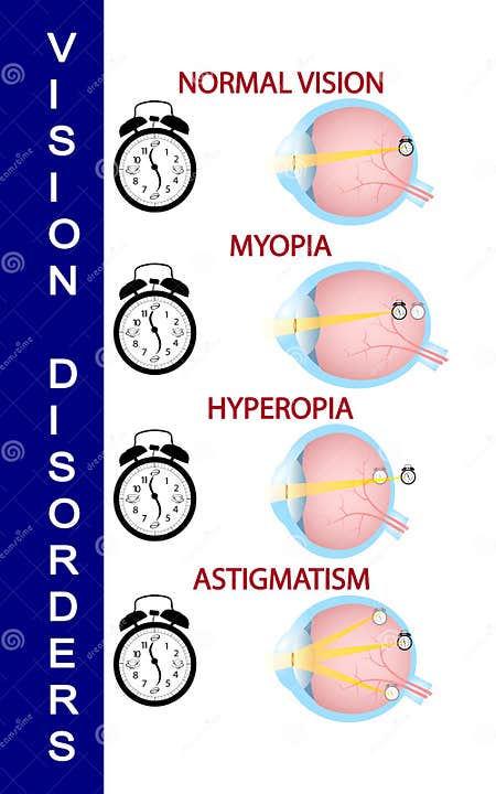 Hyperopia and Hyperopia Corrected by a Plus Lens. Eye Vision Disorder ...