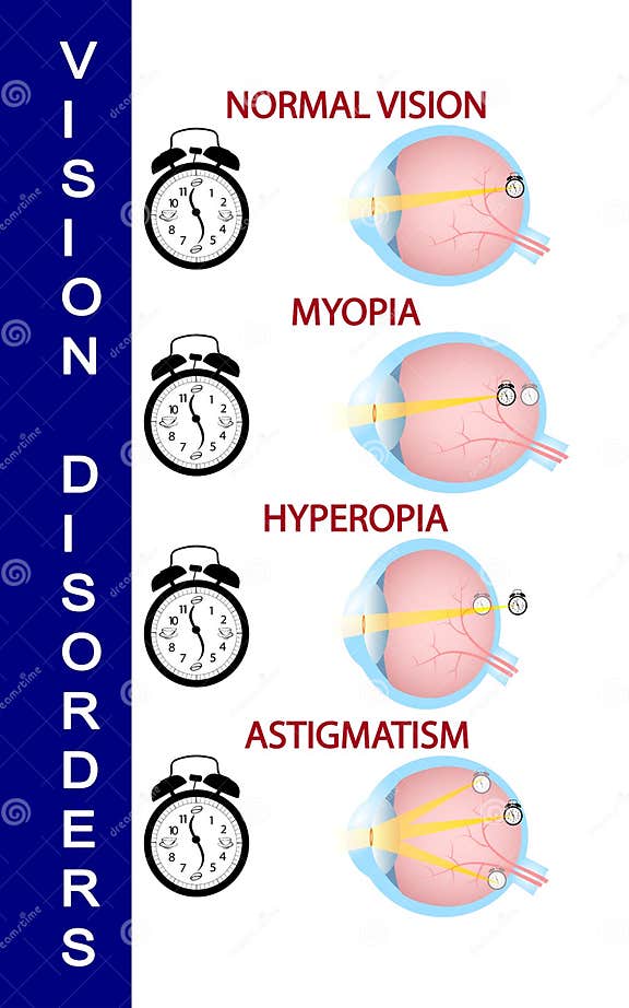 Hyperopia and Hyperopia Corrected by a Plus Lens. Eye Vision Disorder ...