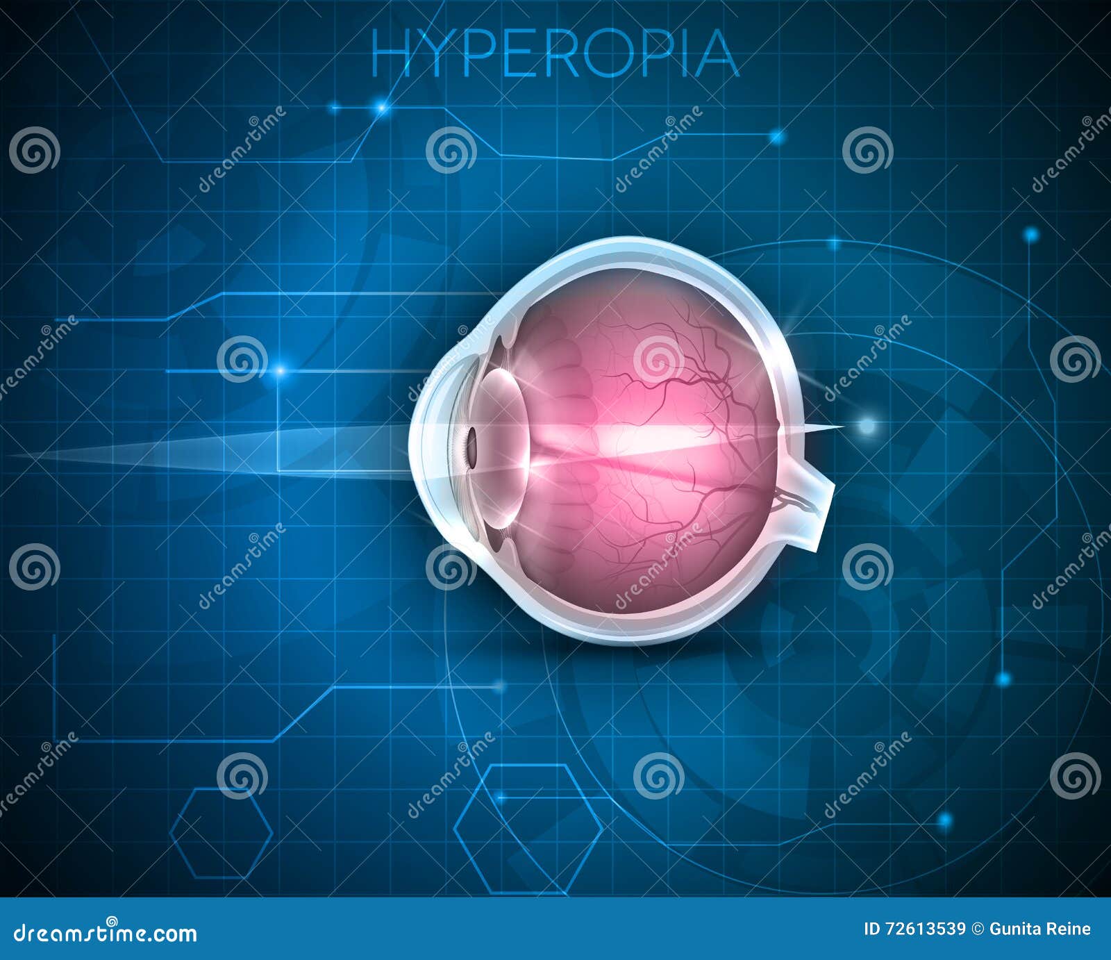 Hyperopia, vision disorder stock vector. Illustration of diagram - 72613539