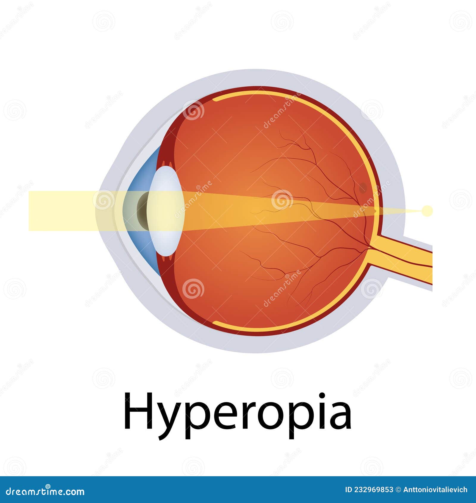 Hyperopia and Vision Disorders Illustration. Eyes Defect Concept Stock ...