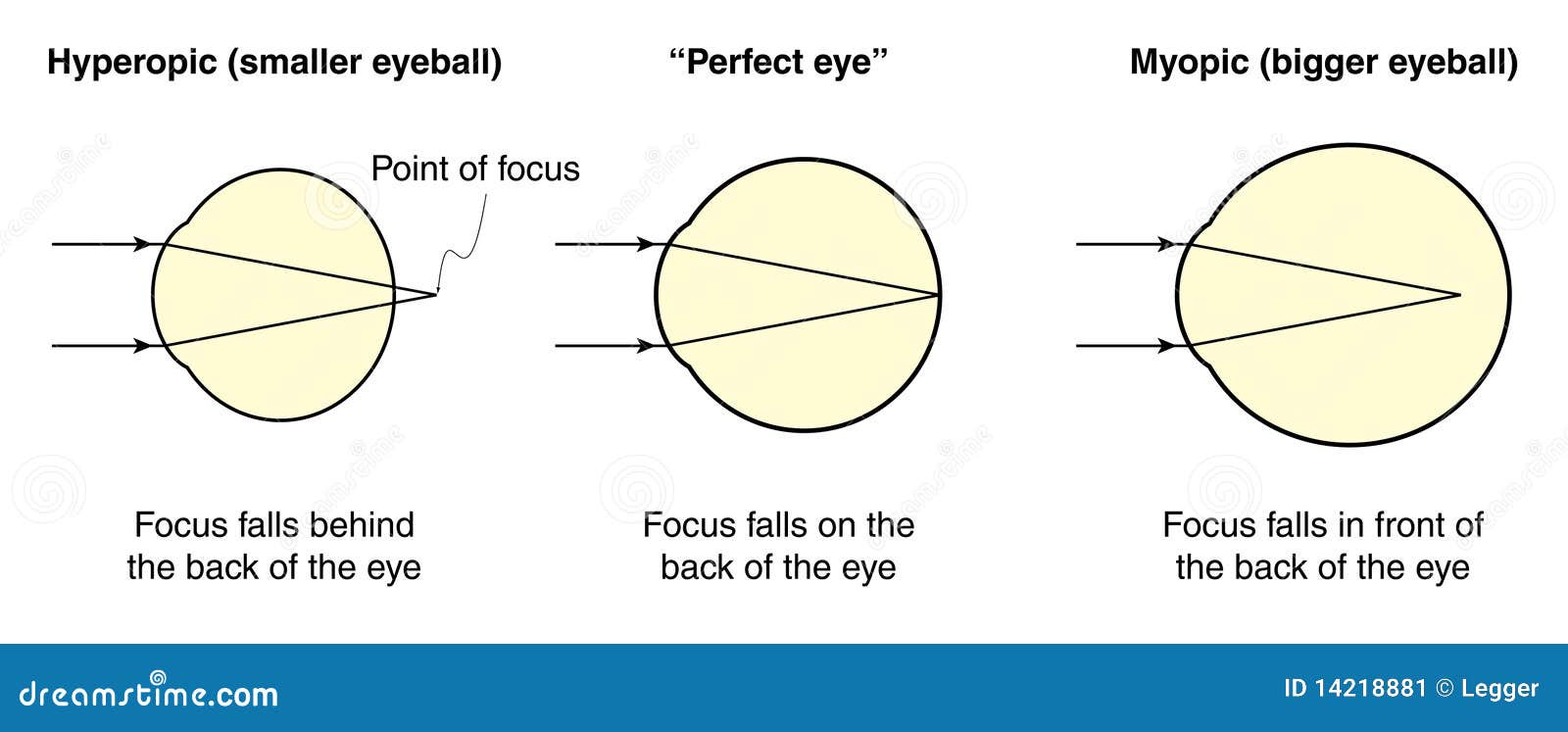 Hyperopic and myopic eyes stock vector. Image of medical - 14218881