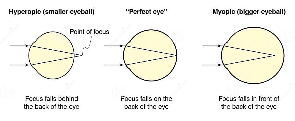 Hyperopic and myopic eyes stock vector. Illustration of science - 14218881