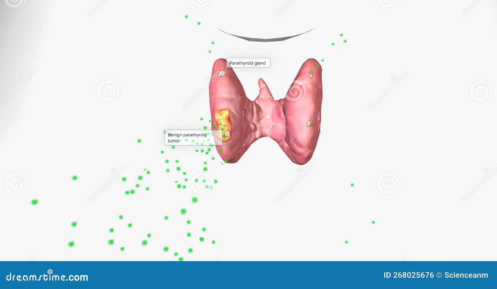 Hyperparathyroidism is a Condition in Which High Amounts of Parathyroid ...