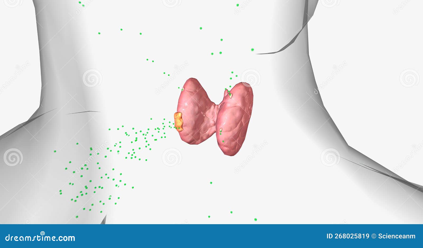 Hyperparathyroidism is a Condition in Which High Amounts of Parathyroid ...