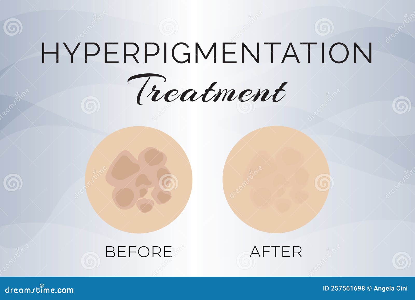 Hyperpigmentation Treatment before and after Illustration Design Stock ...