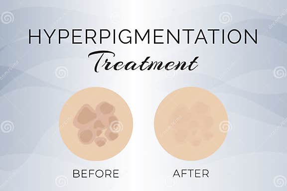 Hyperpigmentation Treatment before and after Illustration Design Stock ...