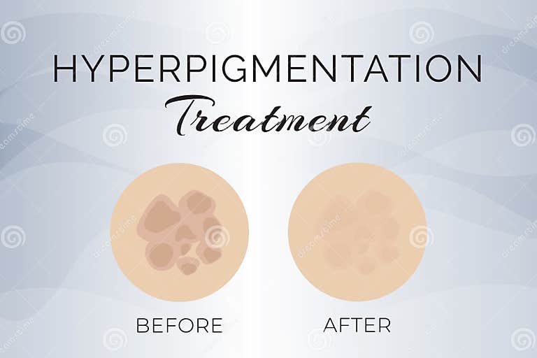 Hyperpigmentation Treatment before and after Illustration Design Stock ...
