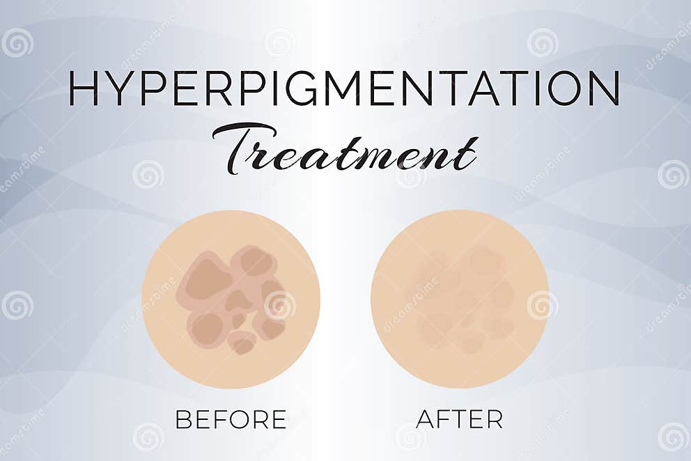 Hyperpigmentation Treatment before and after Illustration Design Stock ...