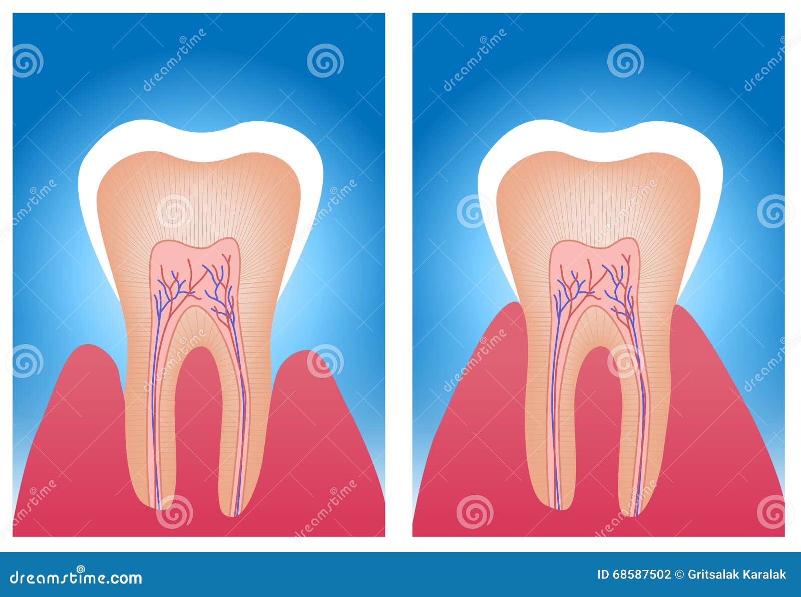 Hypersensitive Teeth And Normal Teeth Vector Illustration ...