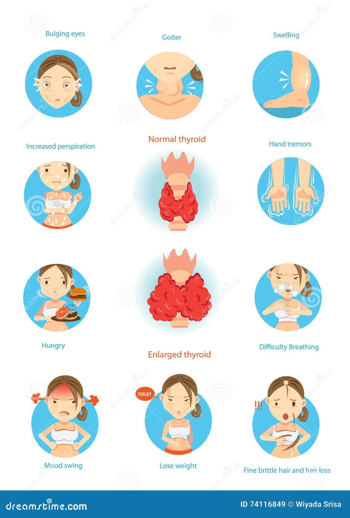 Hyperthyreose vektor abbildung. Illustration von atmung - 74116849