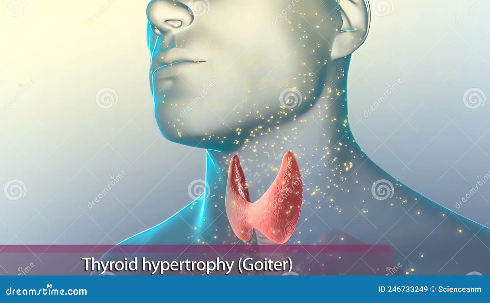 Hyperthyroidism is when the Thyroid Gland Produces More Thyroid Hormone ...