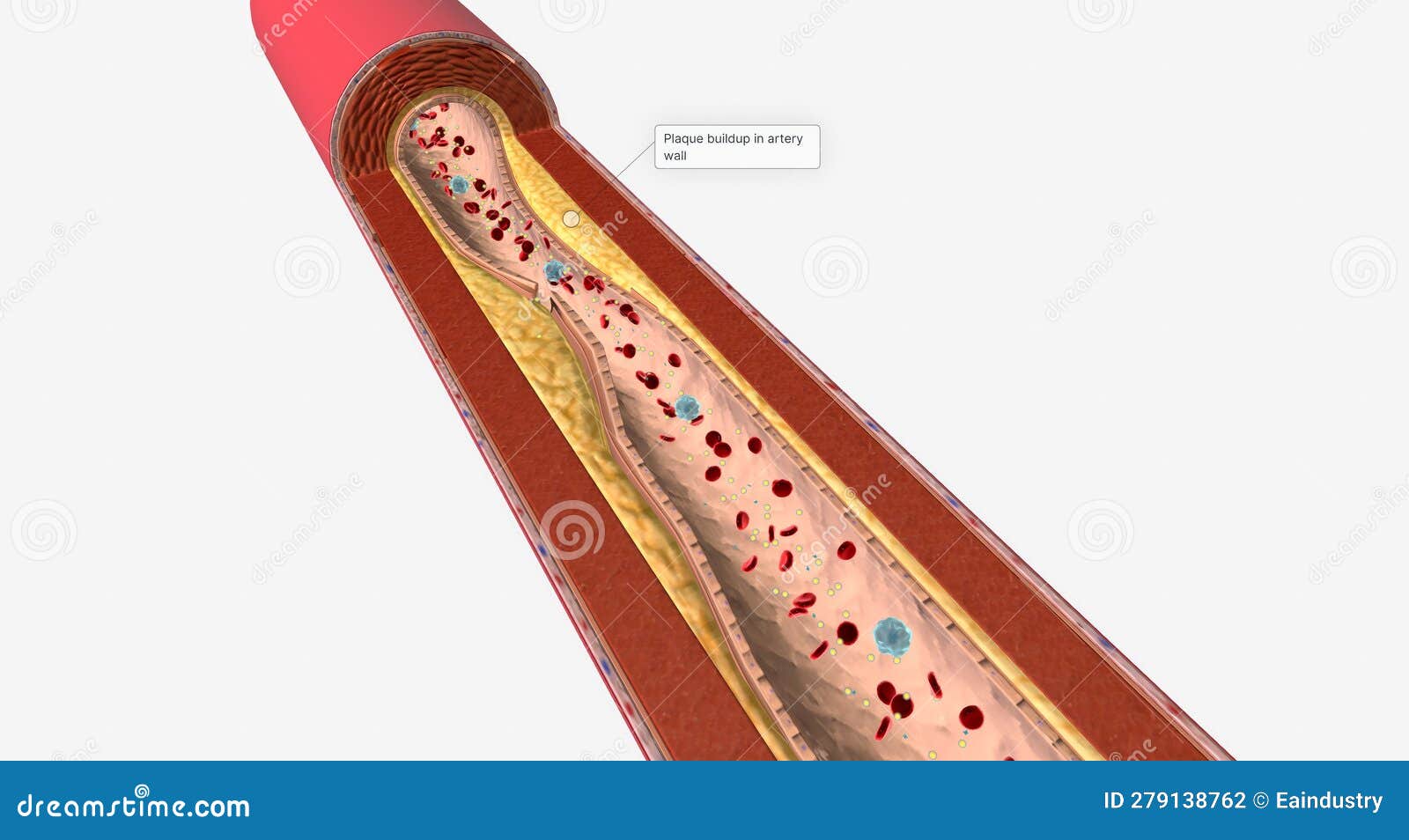 Hypertriglyceridemia is a Common Condition Characterized by High Stock ...
