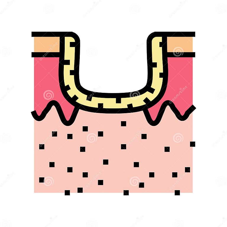 Hypertrophic Acne Scar Color Icon Vector Illustration Stock