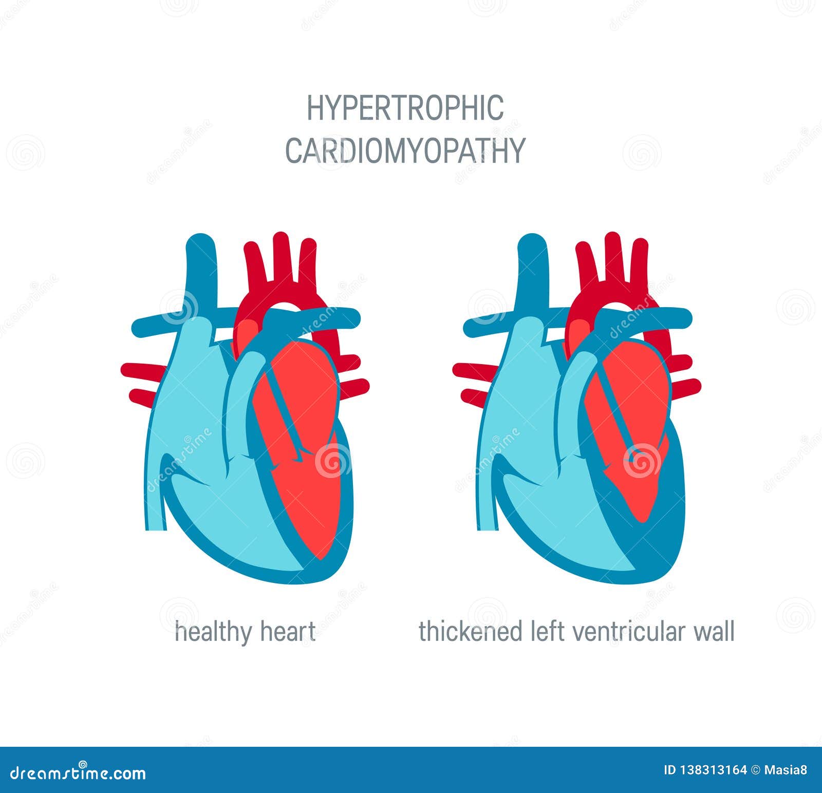 Hypertrophic Cardiomyopathy With Cross Section View Human Heart Muscle