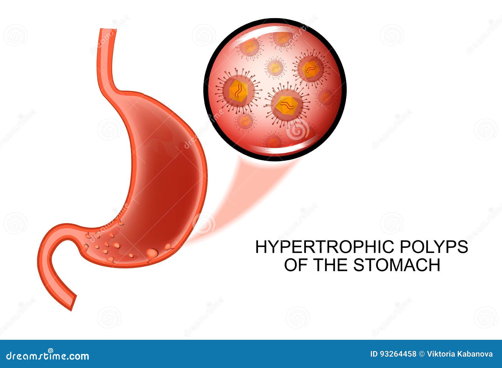 Hypertrophic Polyposis of the Stomach Stock Vector - Illustration of ...