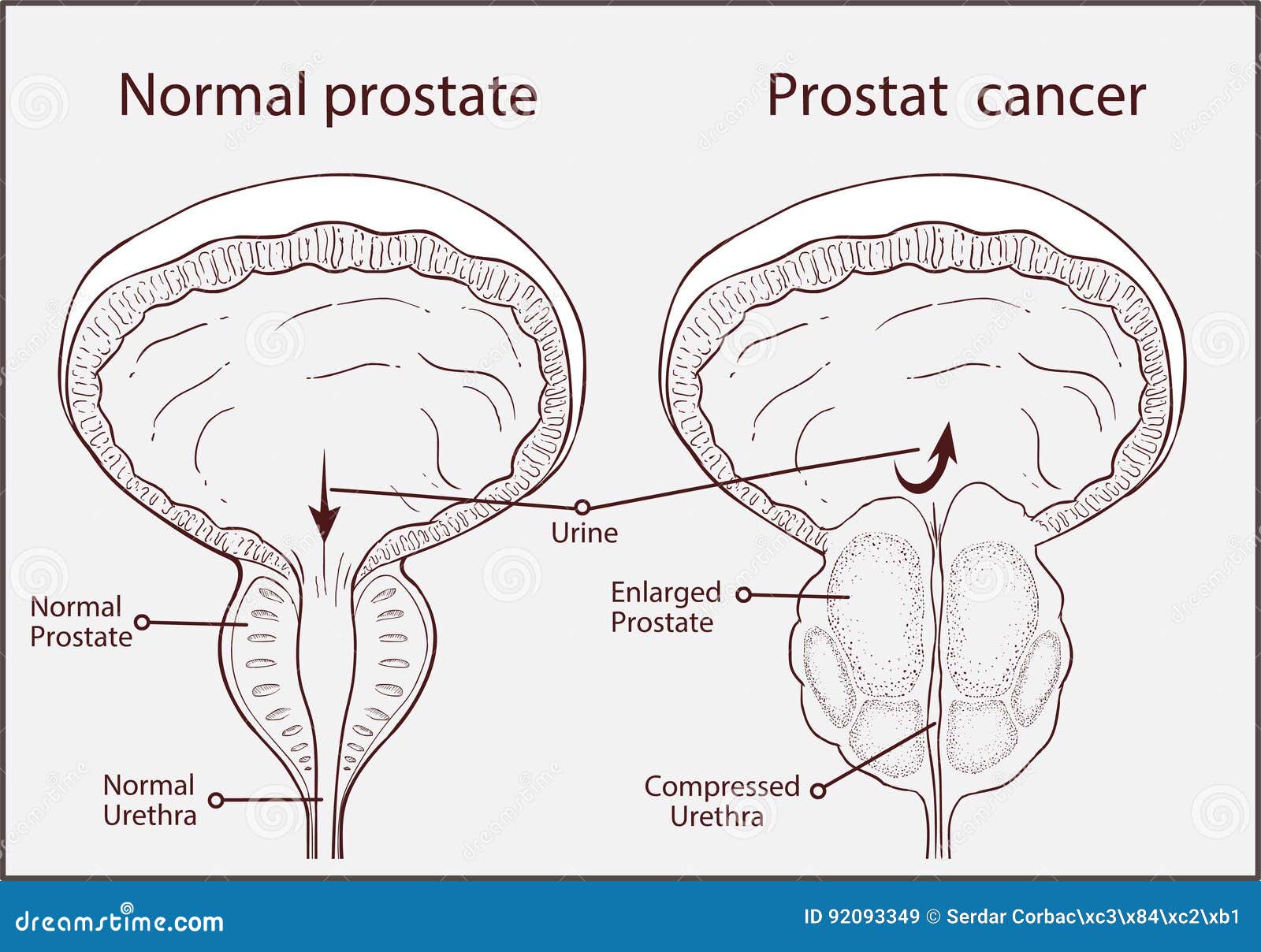 Hypertrophie prostatique illustration de vecteur. Illustration du ...