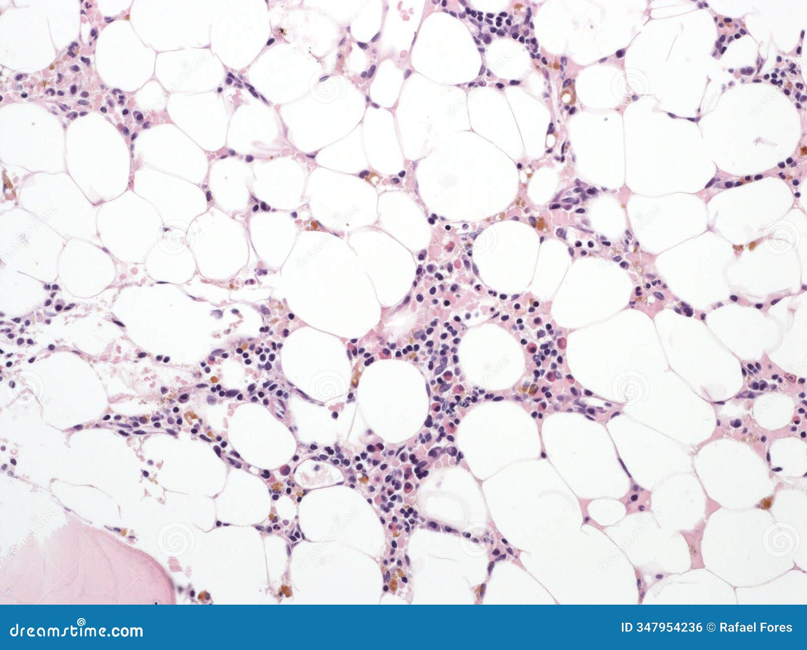 Hypocellular Myelodysplastic Syndrome. Stock Photo - Image of syndrome ...