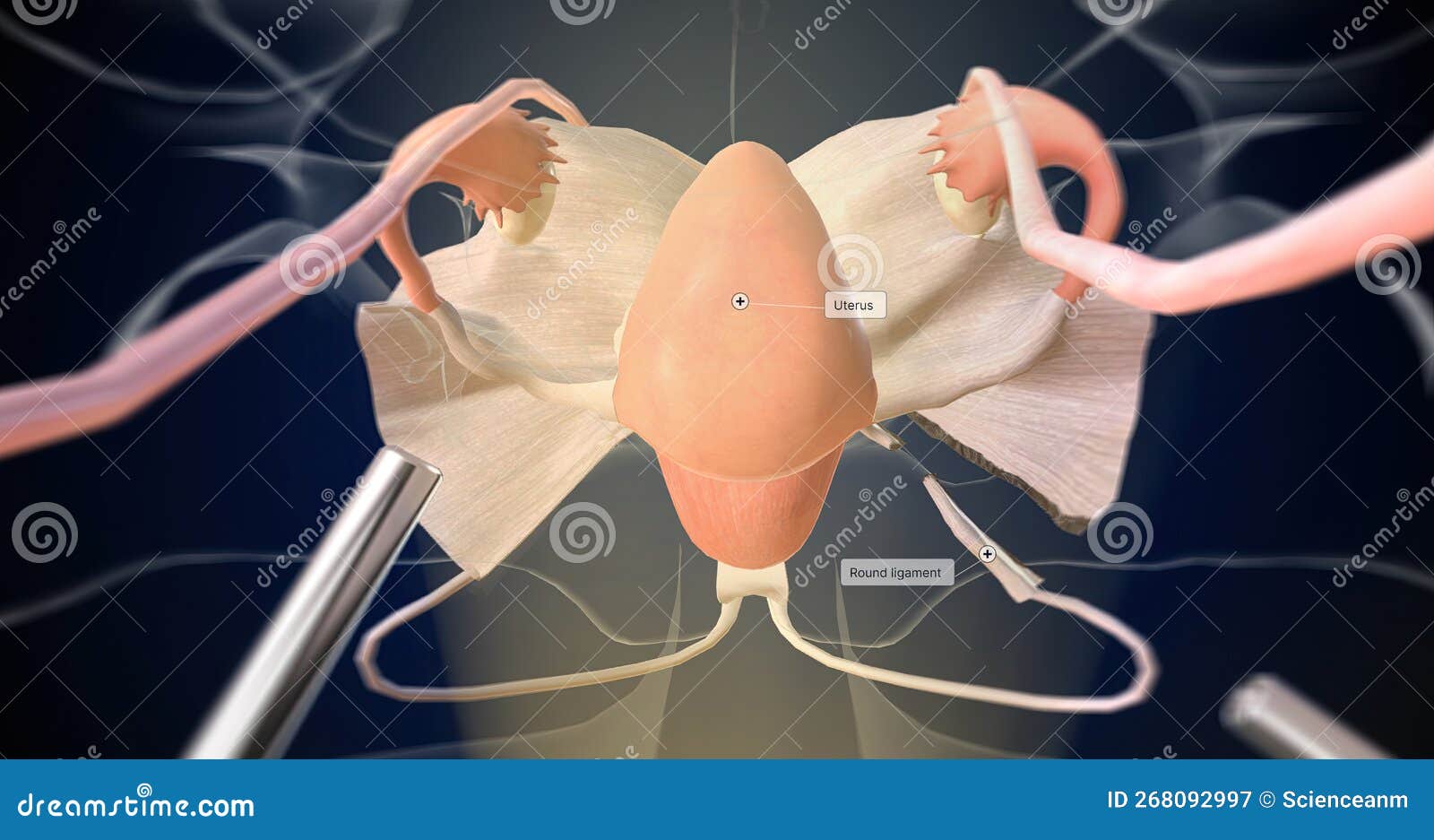 Hysterectomy The Round Ligaments Are Cut And Detached From The Uterus