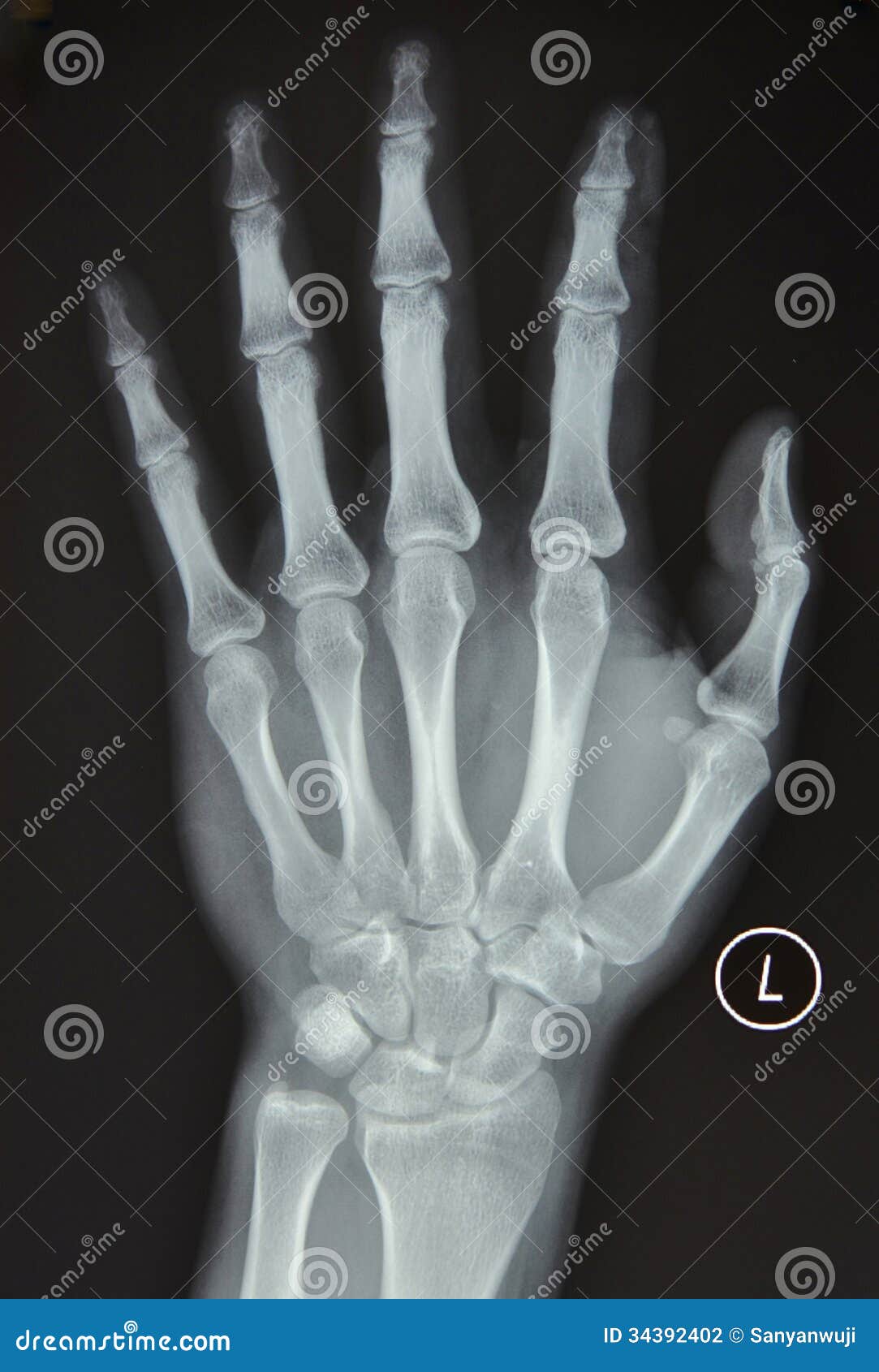 I Raggi X Della Mano Sinistra Fotografia Stock - Immagine di anatomia ...