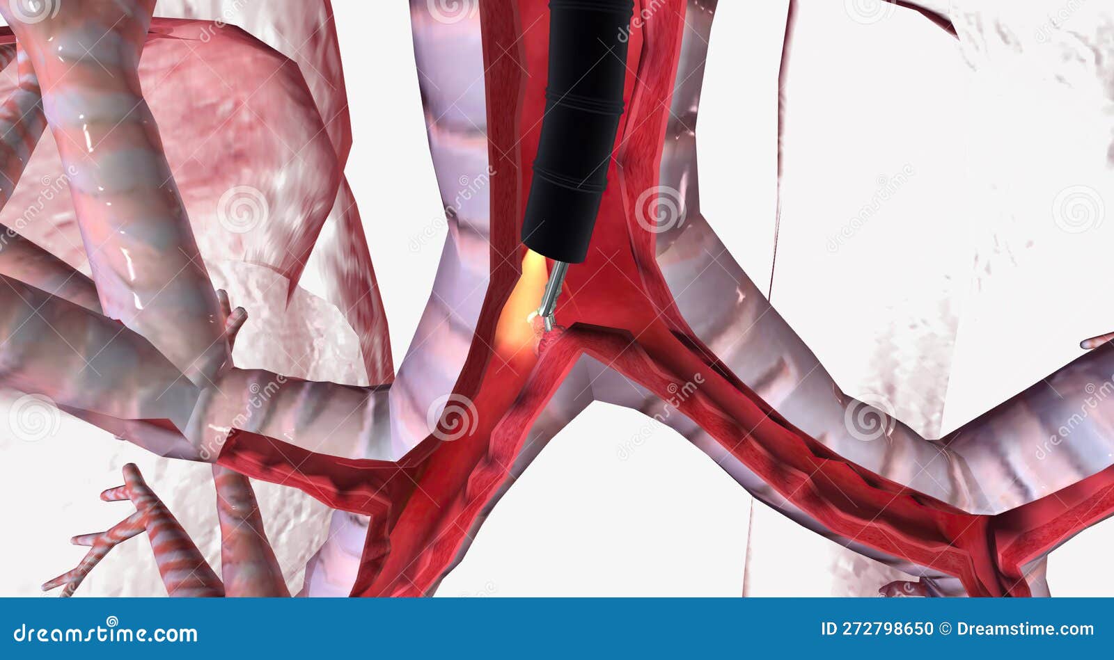 Bronchoscopy. The Patient Is In The Supine Position. Cartoon Vector ...