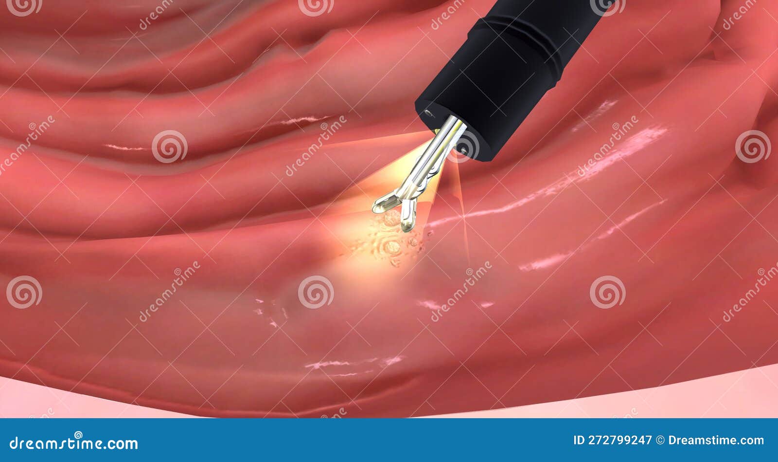 If Abnormal-looking Tissue is Spotted during an Upper Endoscopy, a ...