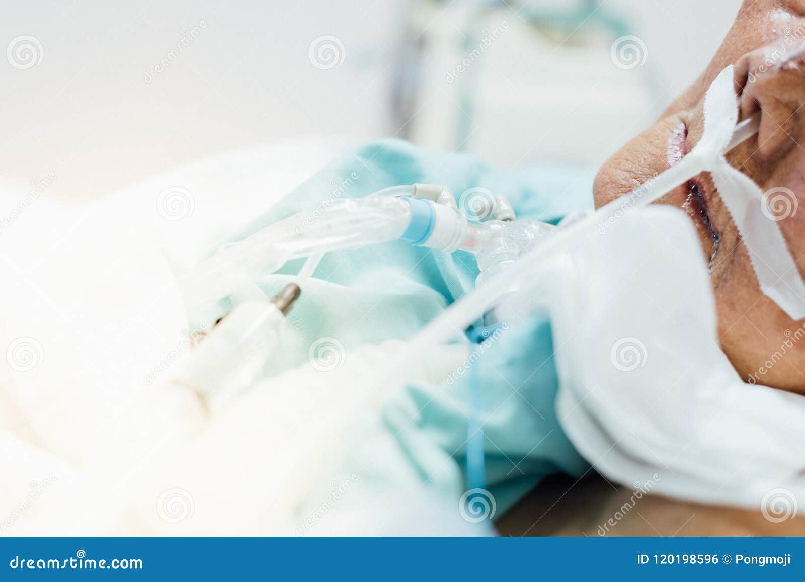 Il Paziente Fa La Tracheotomia Ed Il Ventilatore in Ospedale Fotografia ...