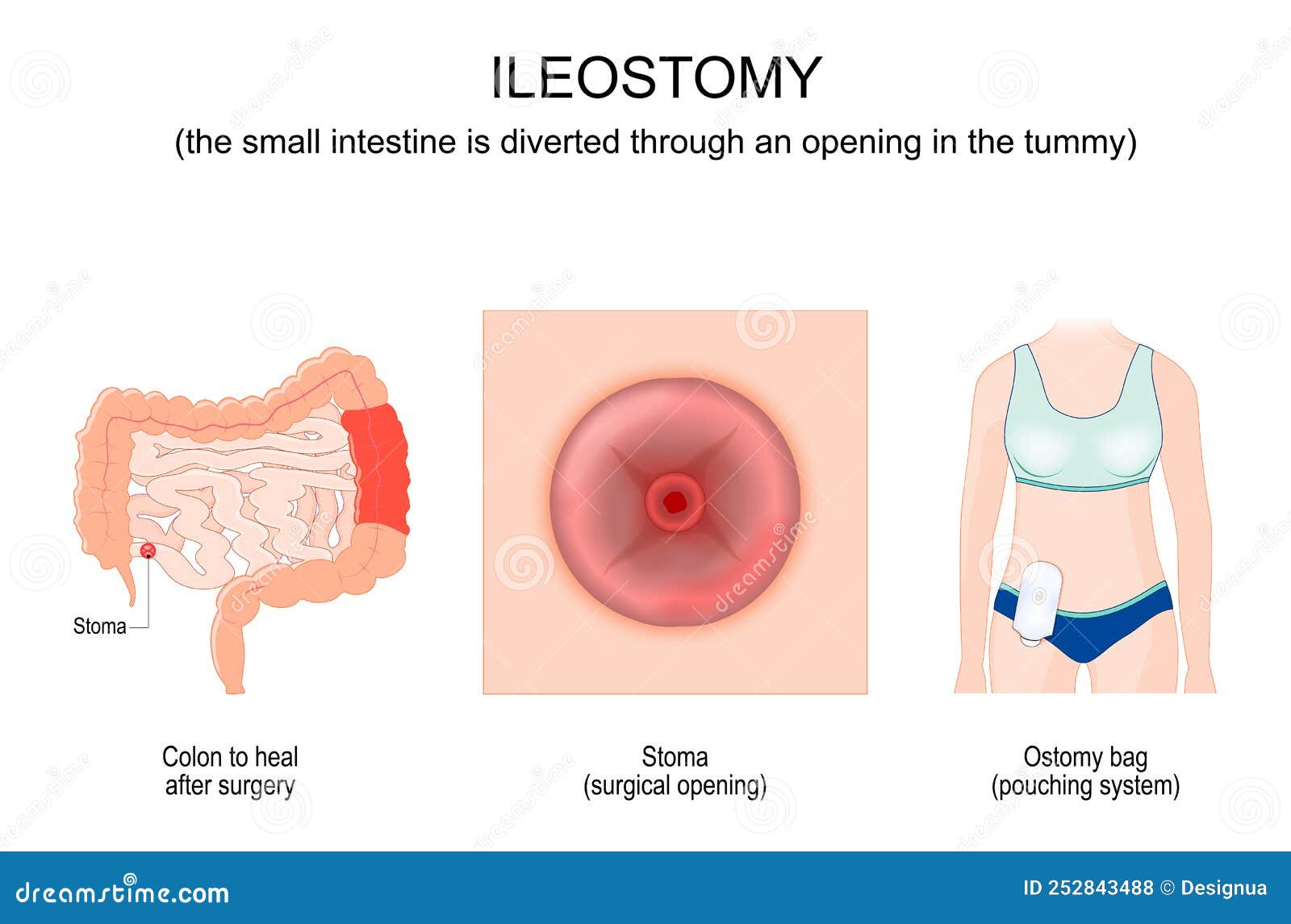 Ileostomy Close Up Of A Stoma Stock Vector Illustration Of Health