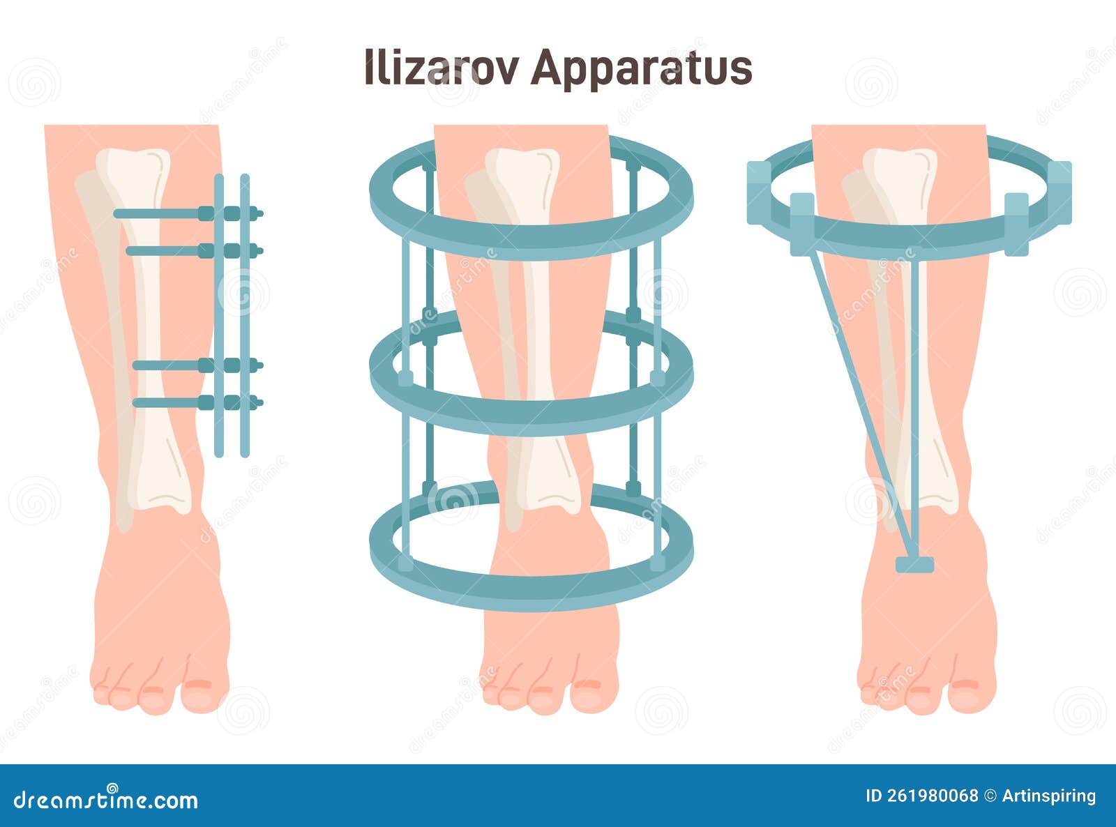 The Ilizarov Apparatus Set External Ring Fixation Technique In Orthopedic Stock Vector