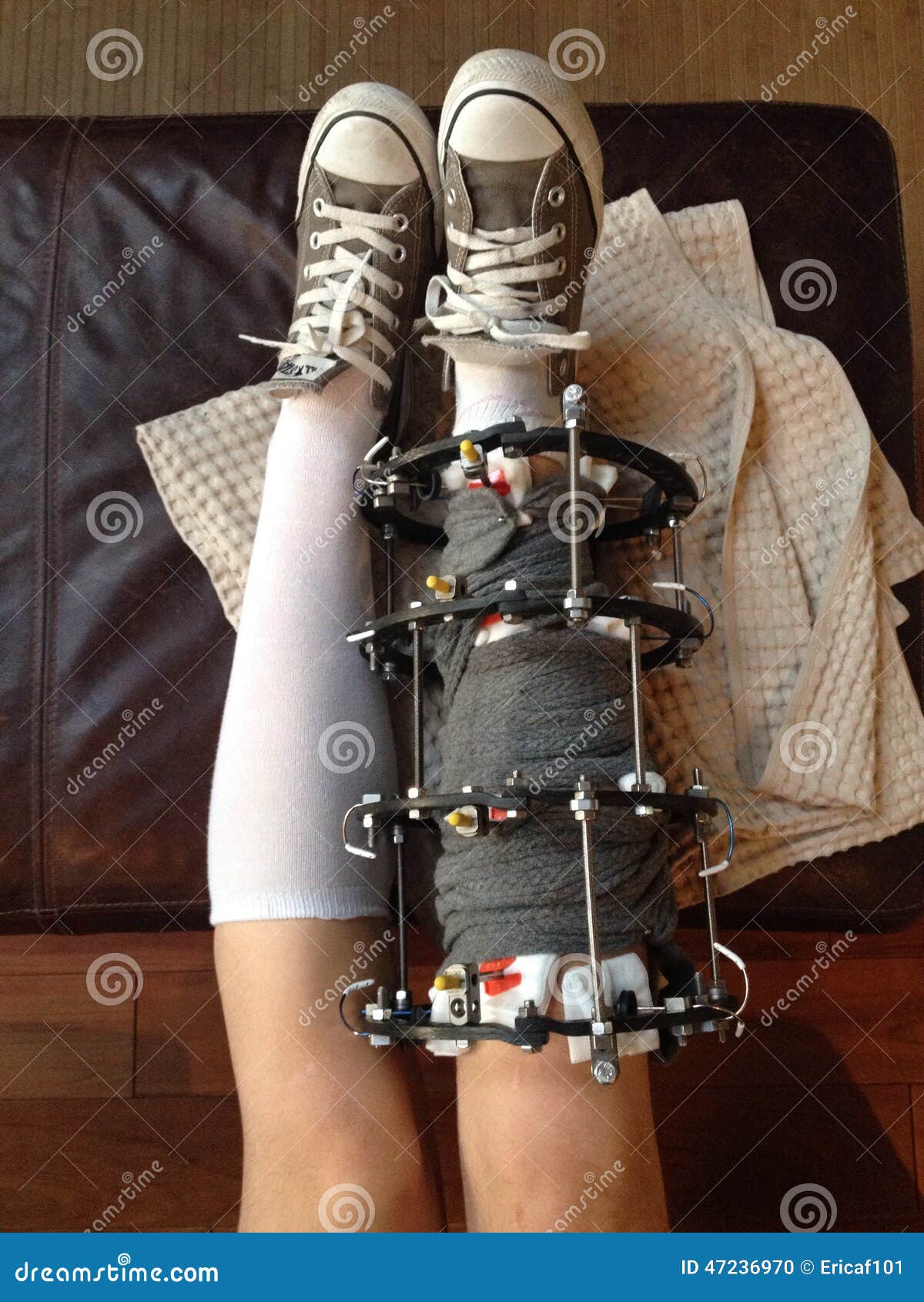 Ilizarov Frame stock illustration. Illustration of pines - 47236970